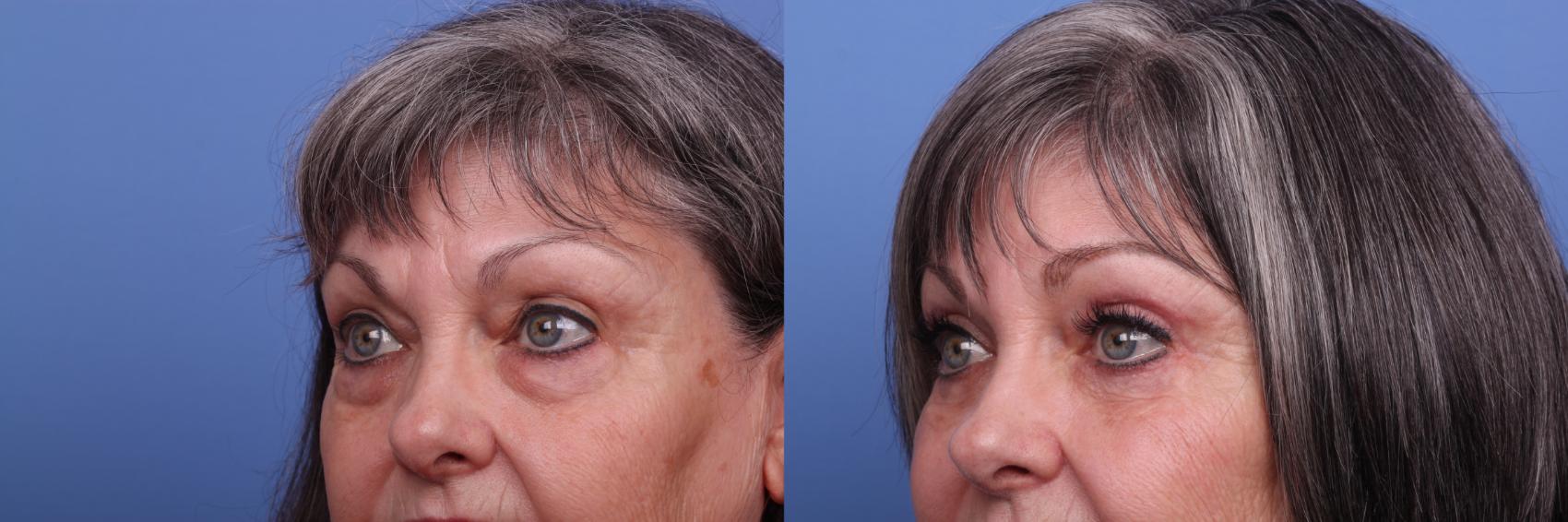 Blepharoplasty Before And After Pictures Case 386 Scottsdale