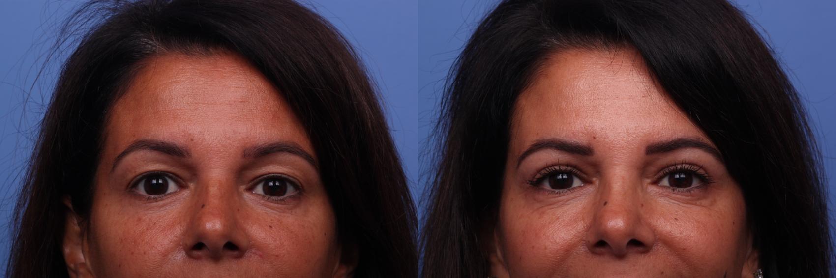 Blepharoplasty Before And After Pictures Case 389 Scottsdale Az