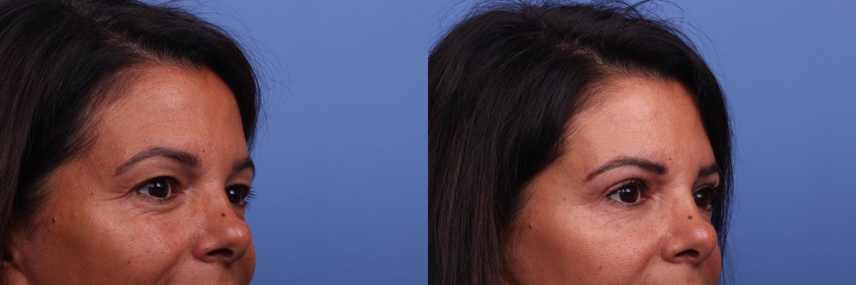 Blepharoplasty Before And After Pictures Case 389 Scottsdale Az