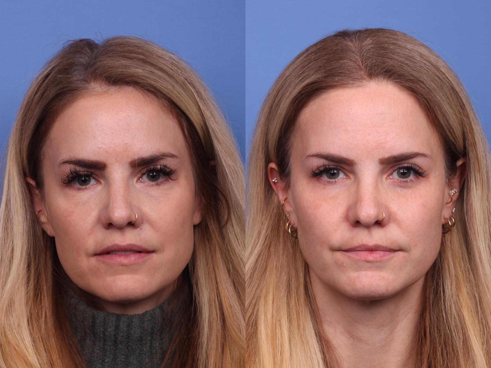 Blepharoplasty Before And After Pictures Case 406 Scottsdale