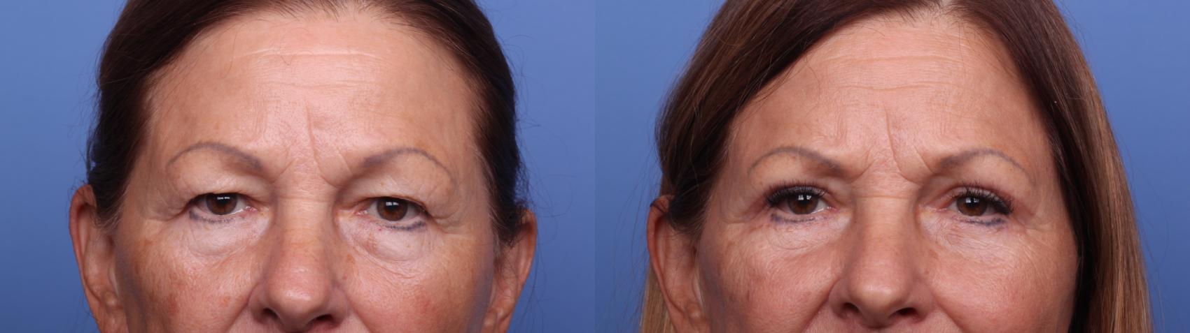 Blepharoplasty Before and After Pictures Case 433 | Scottsdale ...