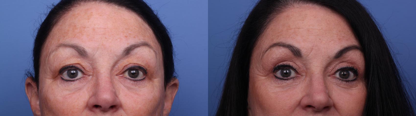 Blepharoplasty Before and After Pictures Case 445 | Scottsdale ...