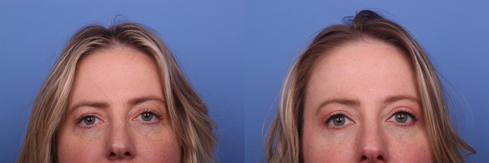 Blepharoplasty Before and After Pictures Case 461 | Scottsdale ...