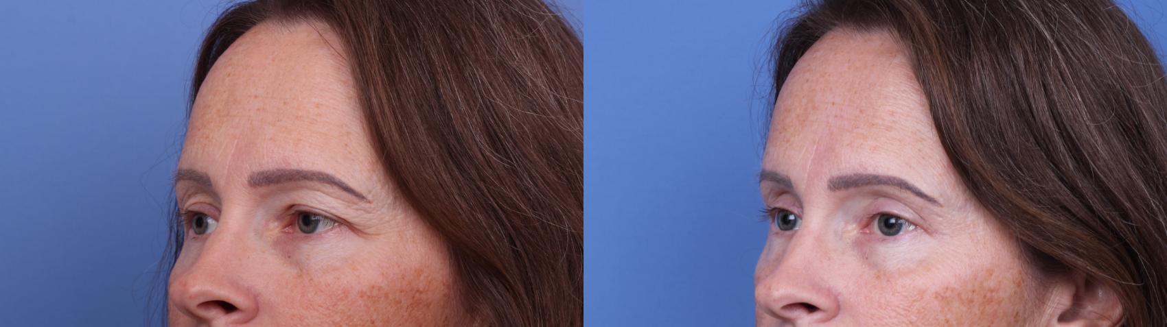 Blepharoplasty Before and After Pictures Case 647 | Scottsdale ...