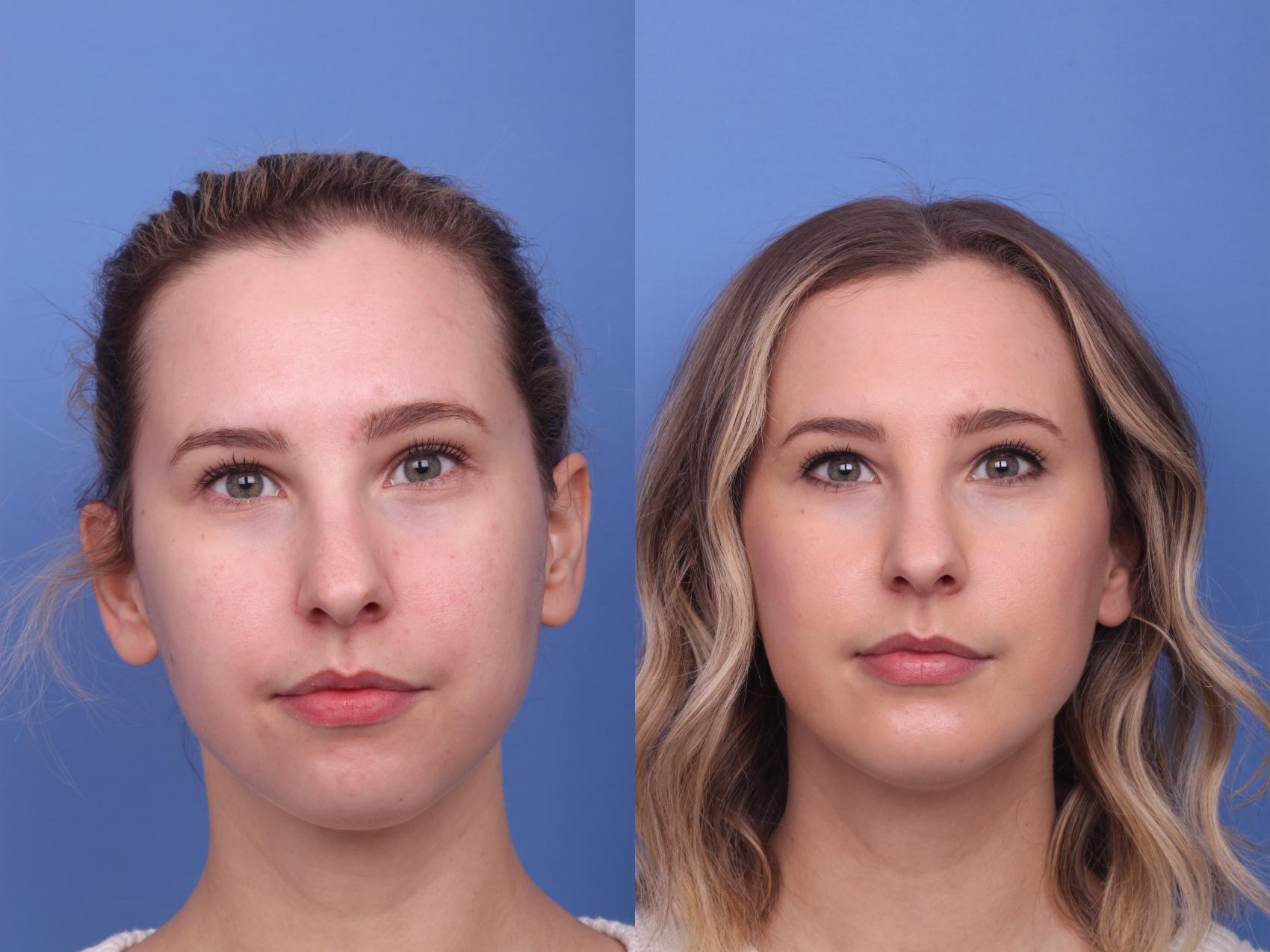 Chin Implant Before and After Pictures Case 282 | Scottsdale & Phoenix ...