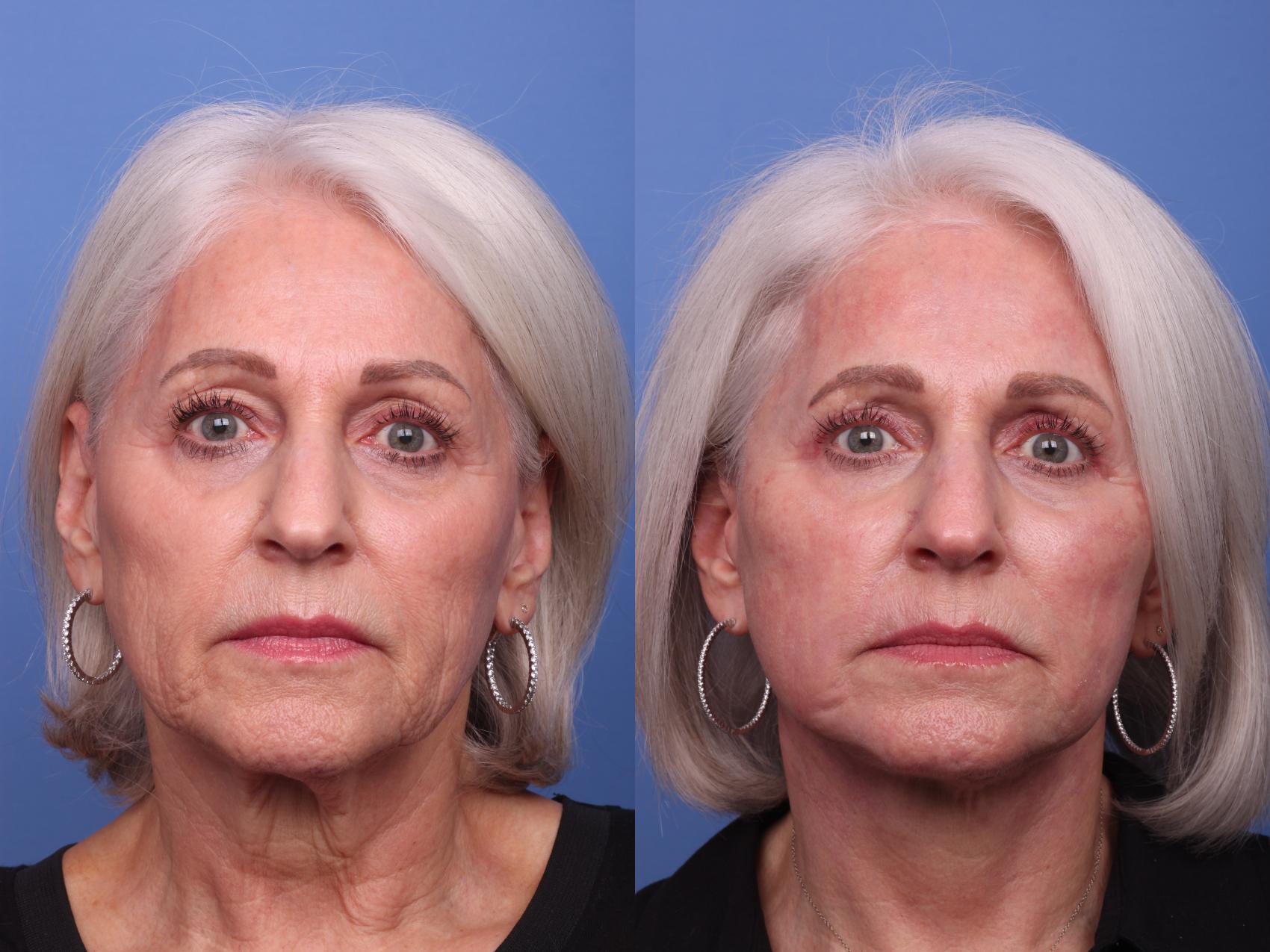 CO2 Laser Resurfacing under Anesthesia Before And After Pictures Case CO2 Laser Resurfacing under Anesthesia Before And After Pictures Case