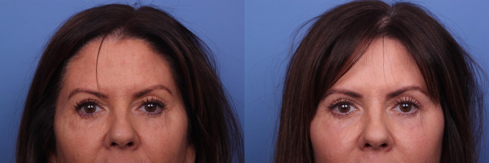 Facelift Before and After Pictures Case 467 | Scottsdale & Phoenix, AZ ...