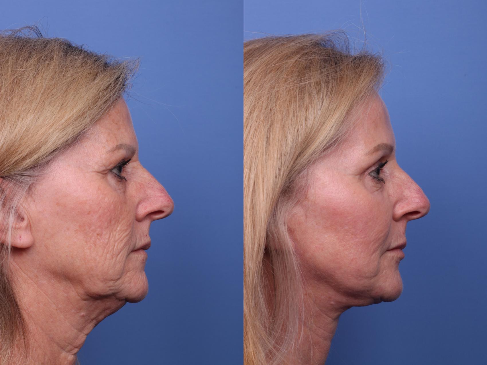Facelift Before and After Pictures Case 529 | Scottsdale, AZ | Hobgood ...