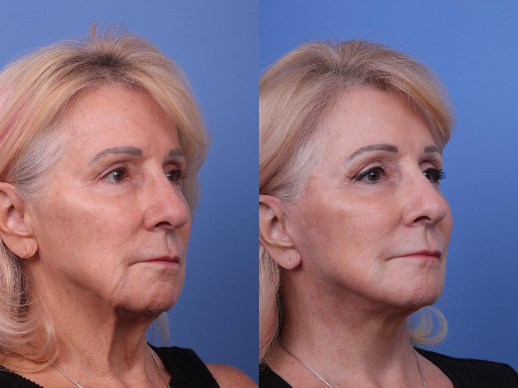 Facelift Before and After Pictures Case 603 | Scottsdale & Phoenix, AZ ...