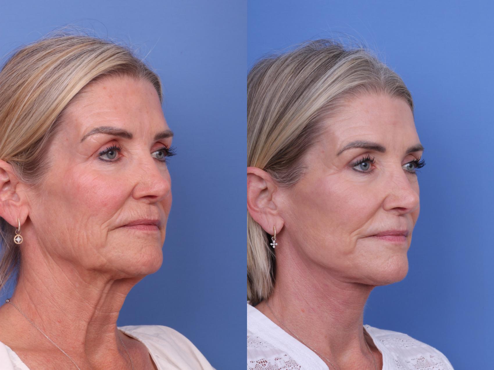 Facelift Before and After Pictures Case 633 | Scottsdale & Phoenix, AZ ...