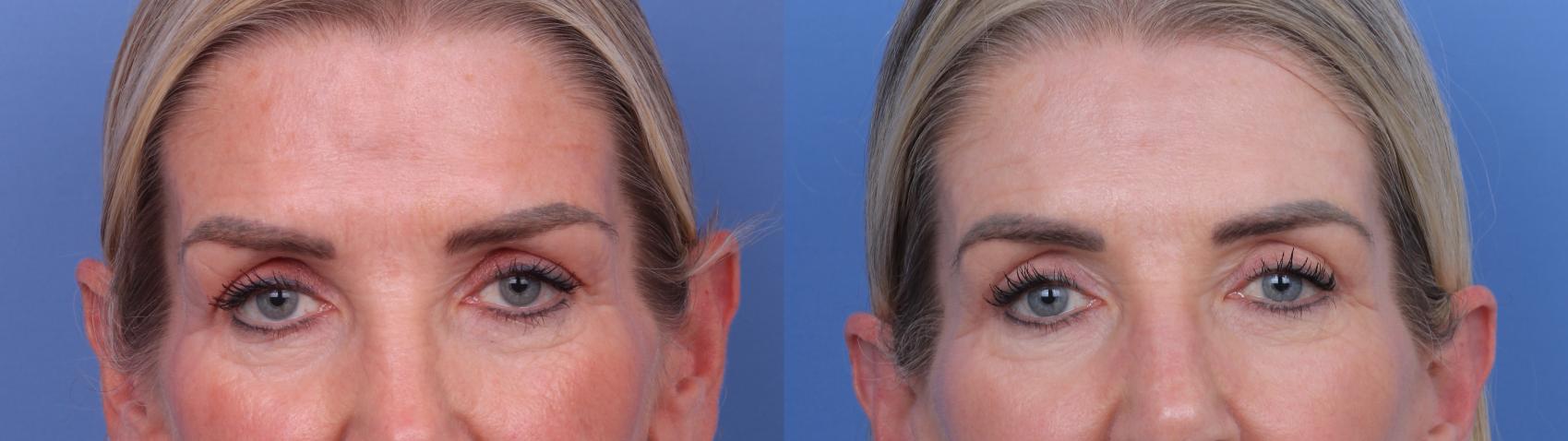 Facelift Before and After Pictures Case 633 | Scottsdale & Phoenix, AZ ...