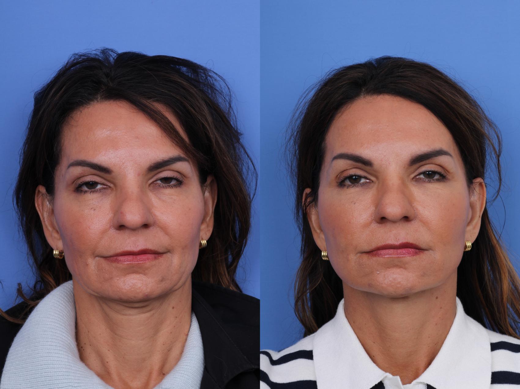Facelift Before and After Pictures Case 635 | Scottsdale & Phoenix, AZ ...