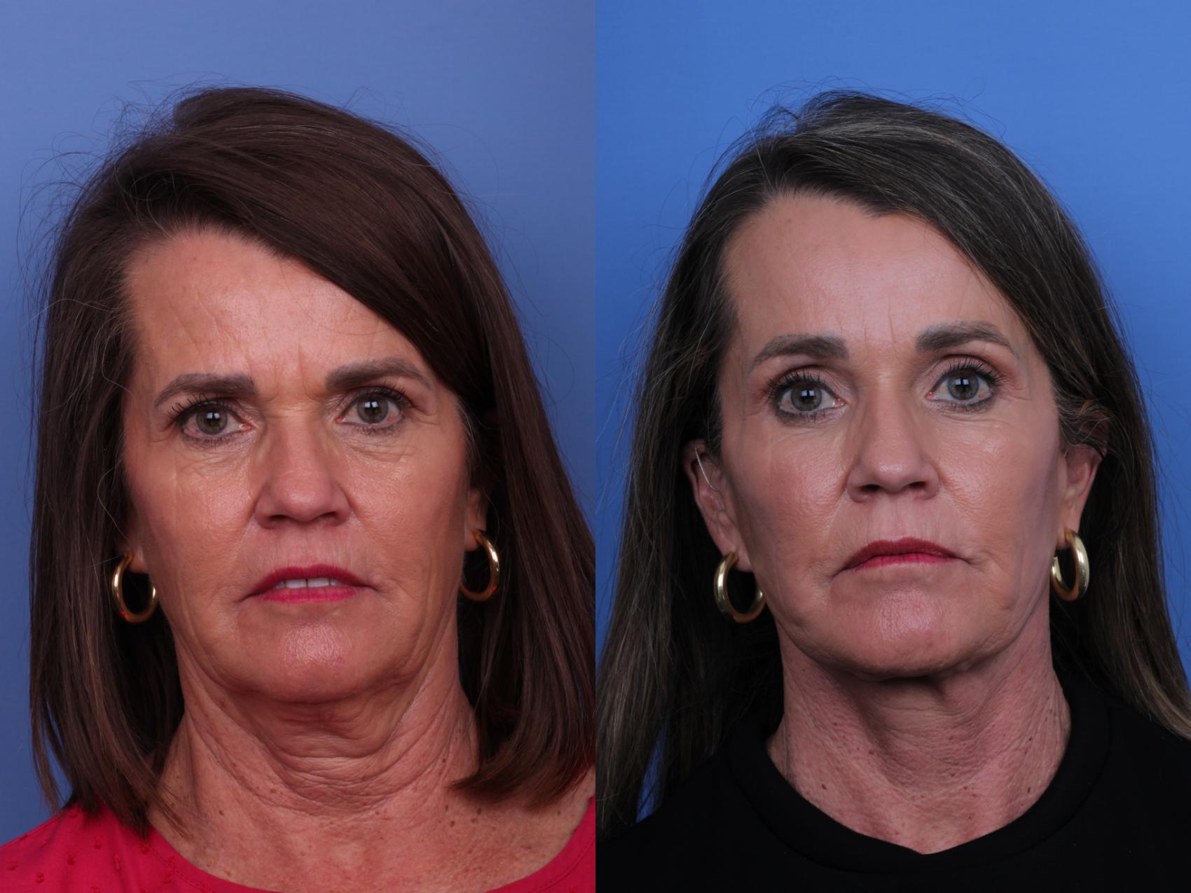 Blepharoplasty Before and After Pictures Case 650 | Scottsdale ...