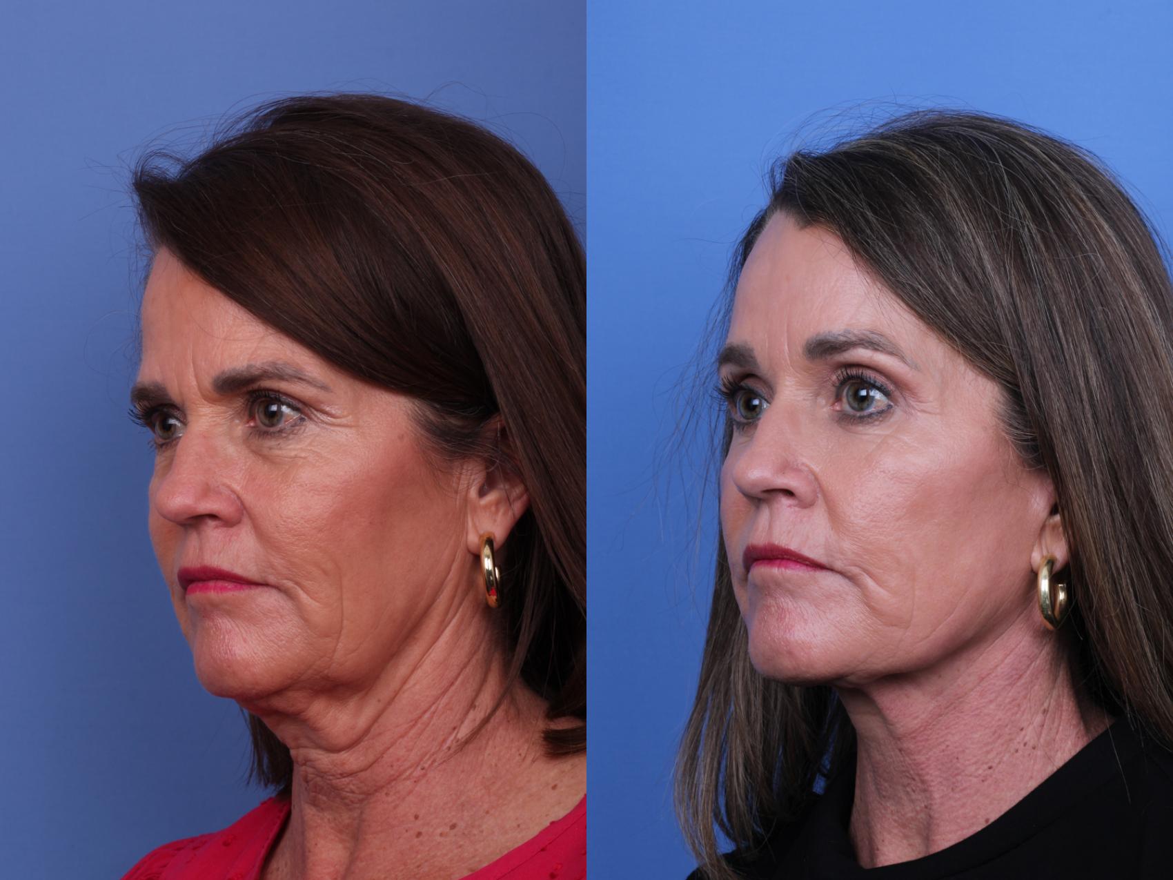 Blepharoplasty Before and After Pictures Case 650 | Scottsdale ...