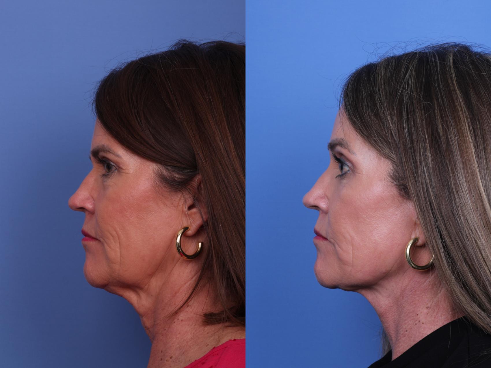Blepharoplasty Before and After Pictures Case 650 | Scottsdale ...