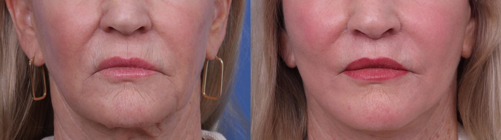 CO2 Laser Resurfacing (under anesthesia) Before and After Pictures Case ...