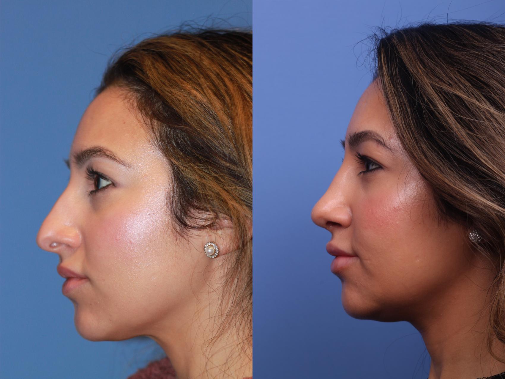 Rhinoplasty Before and After Pictures Case 183 | Scottsdale & Phoenix ...