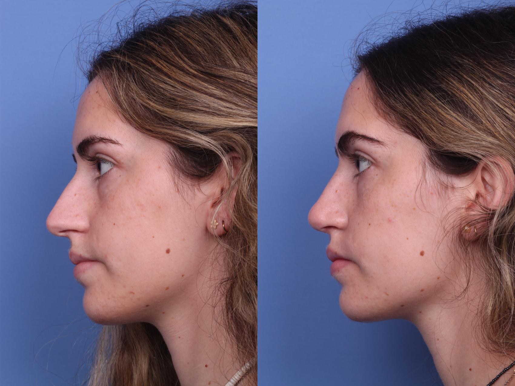 Rhinoplasty Before and After Pictures Case 231 | Scottsdale & Phoenix ...