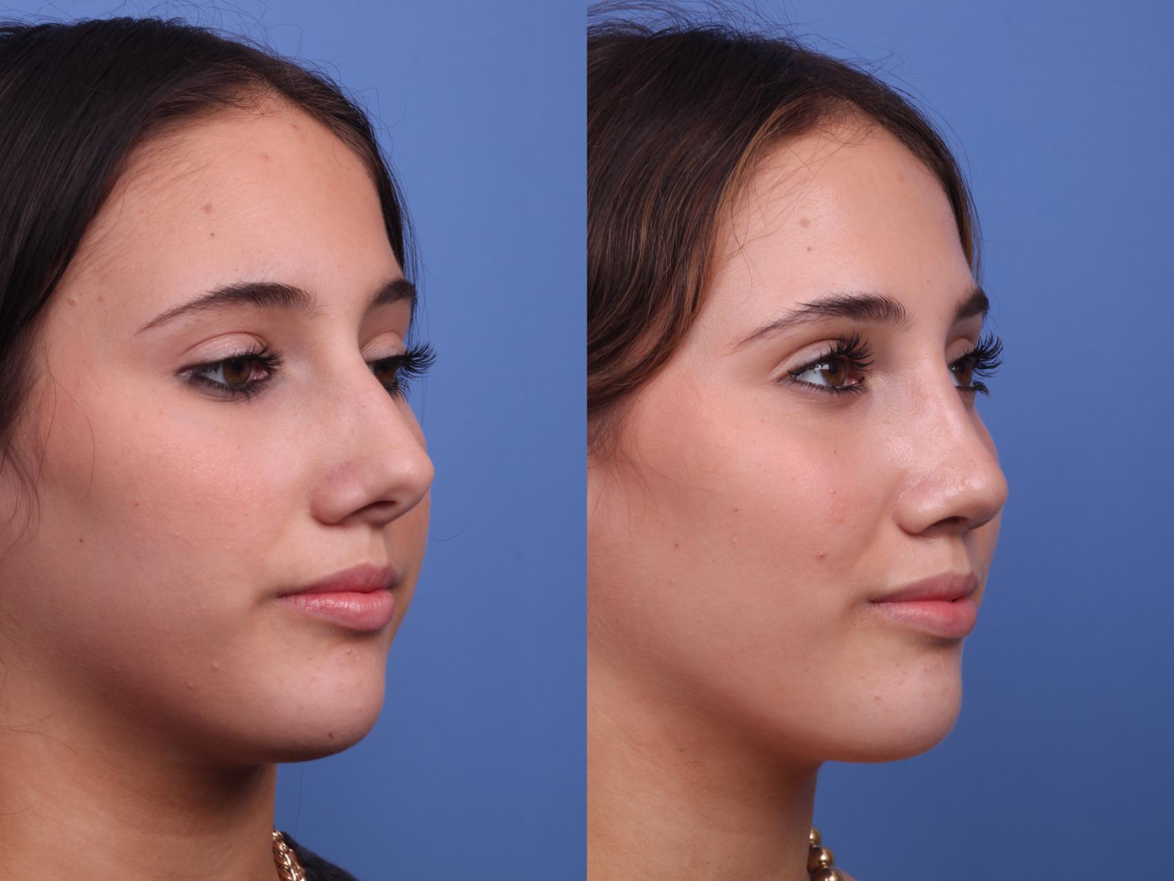 Rhinoplasty Before and After Pictures Case 330 | Scottsdale & Phoenix ...