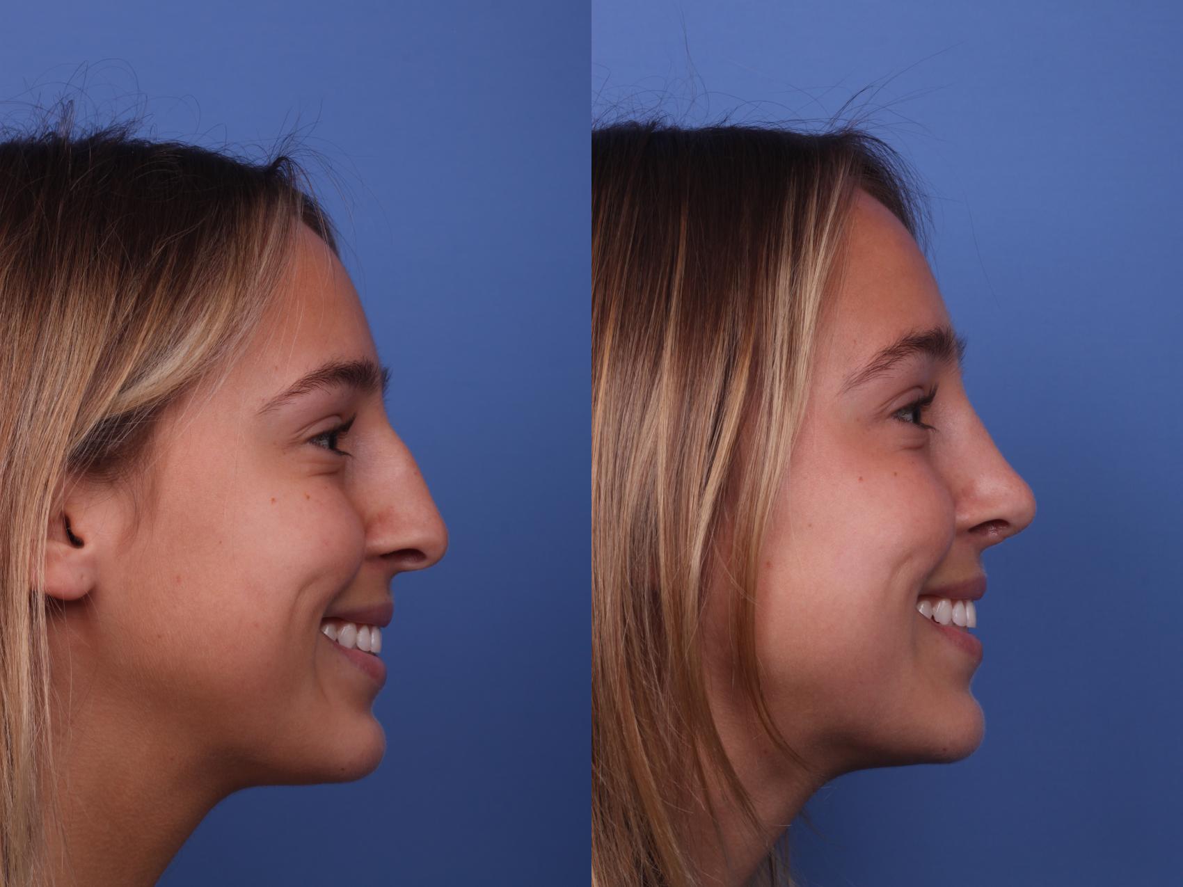 Rhinoplasty Before and After Pictures Case 339 | Scottsdale & Phoenix ...
