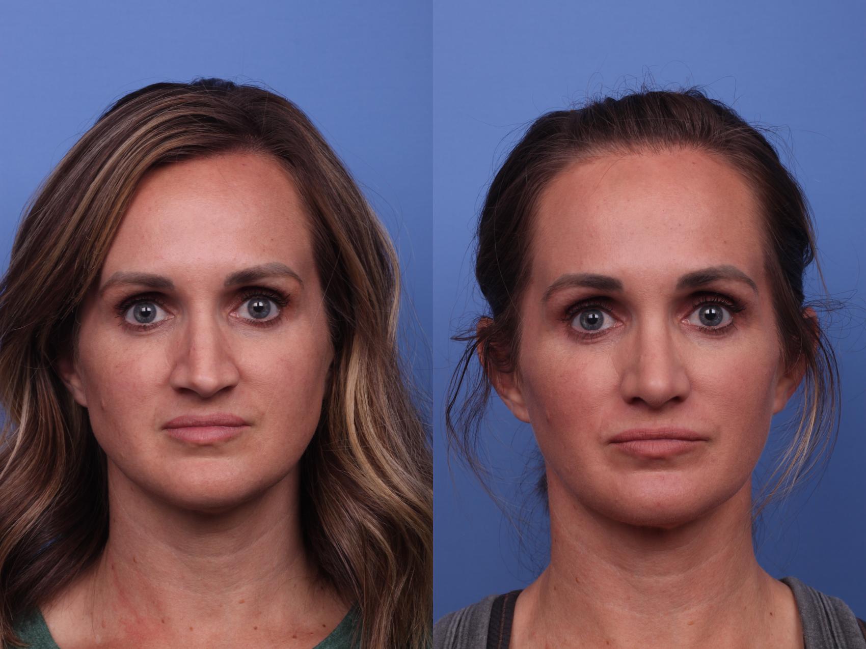 Rhinoplasty Before and After Pictures Case 344 | Scottsdale & Phoenix ...