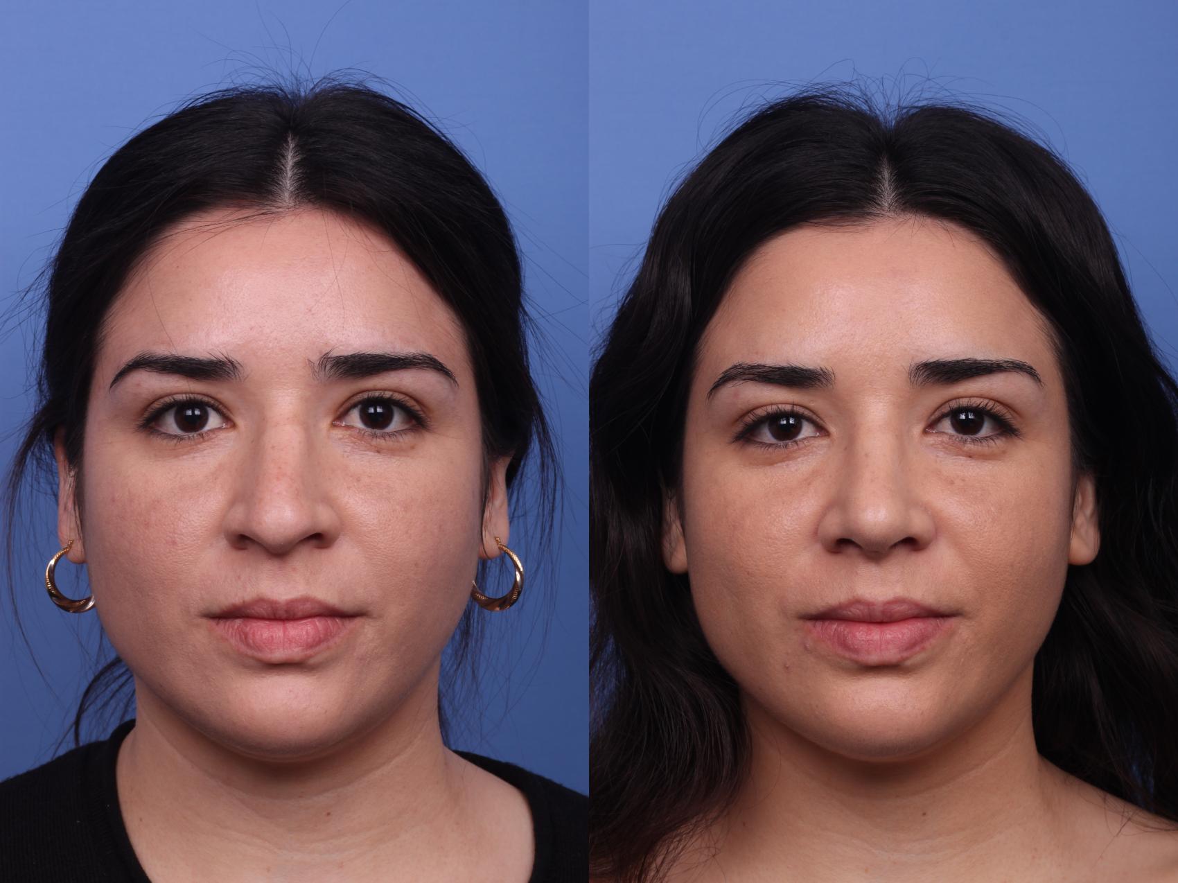 Rhinoplasty Before and After Pictures Case 352 | Scottsdale & Phoenix ...