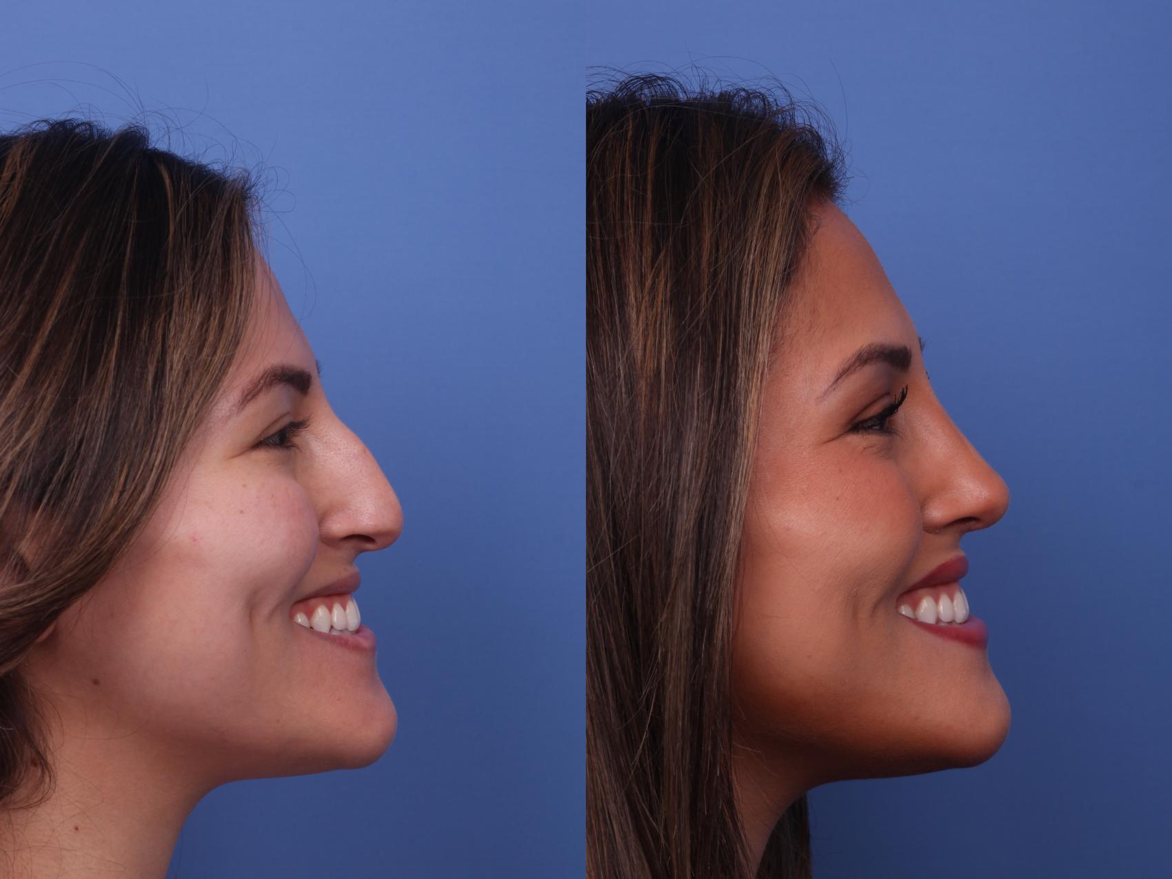 Rhinoplasty Before and After Pictures Case 382 | Scottsdale & Phoenix ...