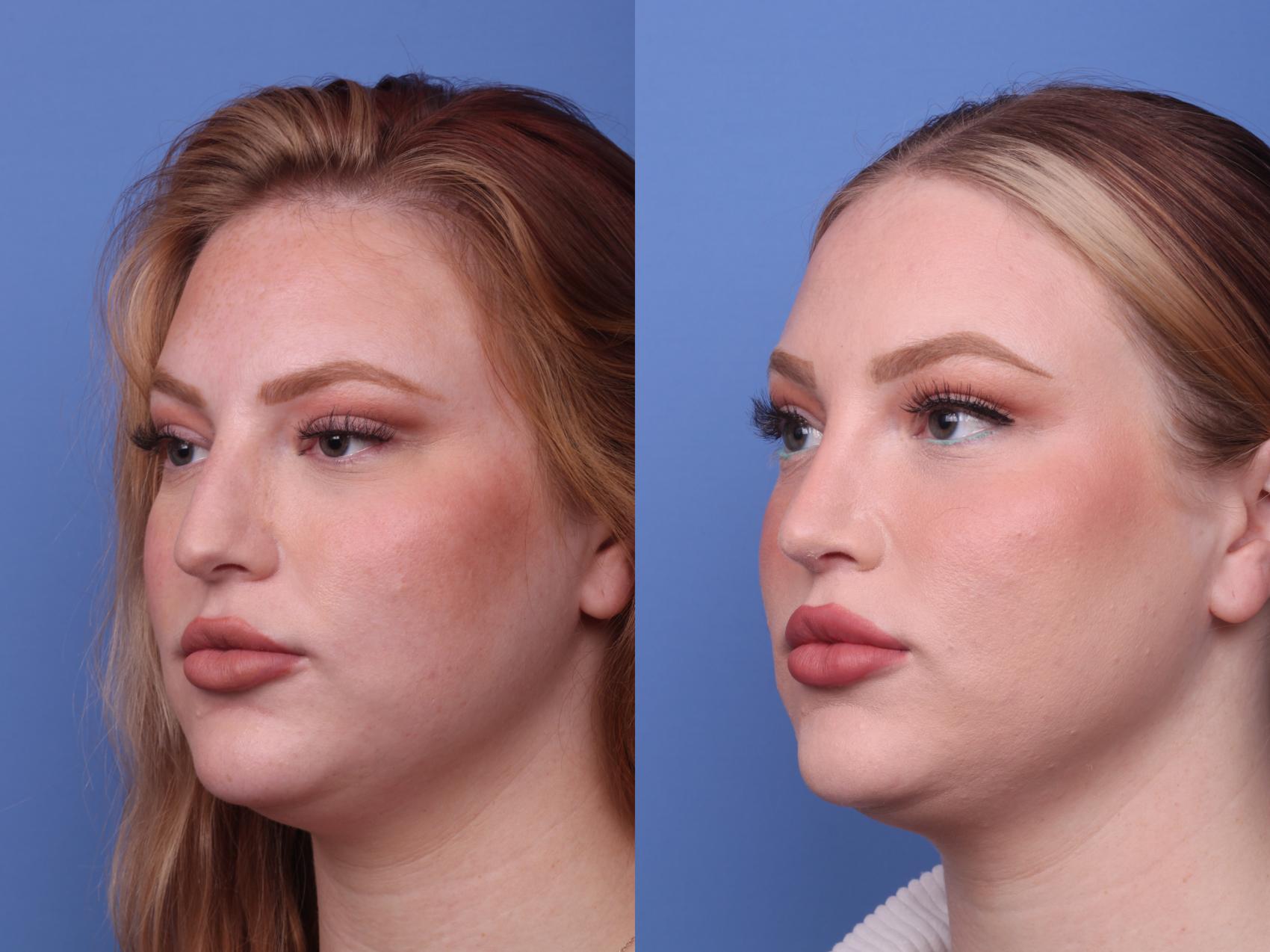 Rhinoplasty Before and After Pictures Case 388 | Scottsdale & Phoenix ...