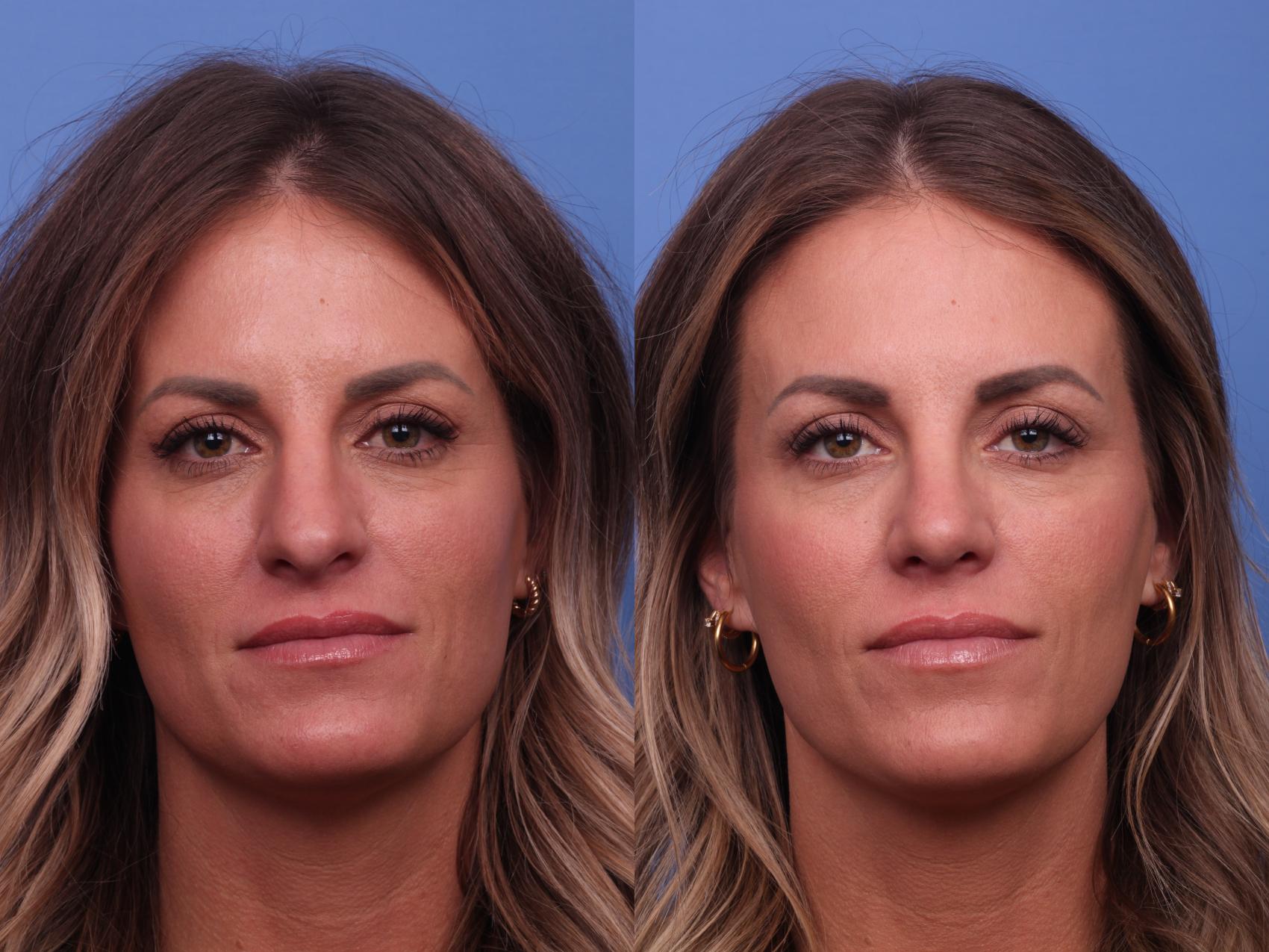 Rhinoplasty Before and After Pictures Case 395 | Scottsdale & Phoenix ...