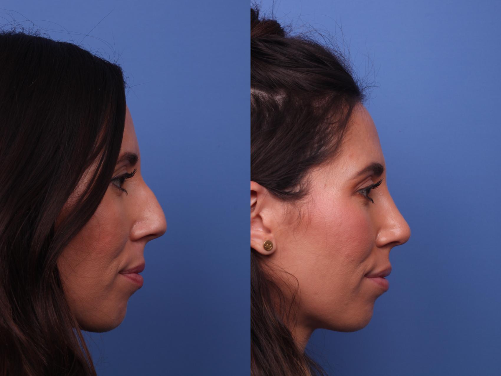 Rhinoplasty Before and After Pictures Case 396 | Scottsdale & Phoenix ...