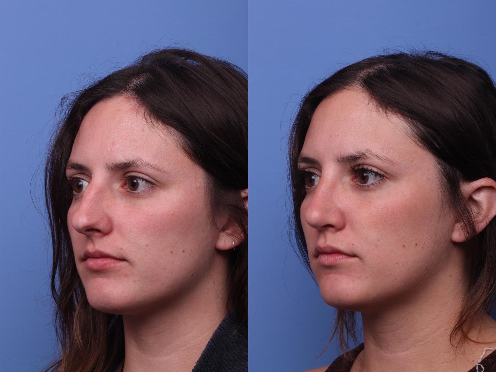 Rhinoplasty Before and After Pictures Case 409 | Scottsdale & Phoenix ...