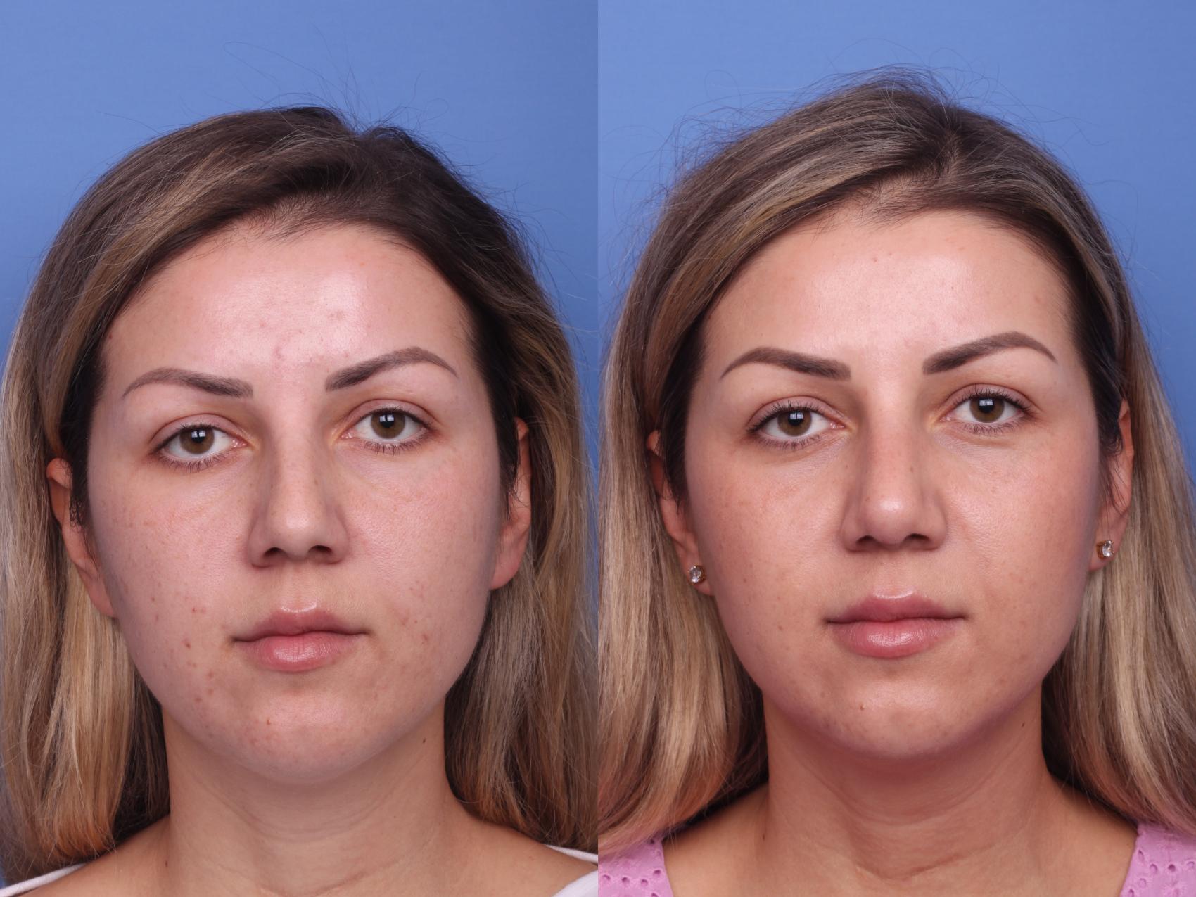 Rhinoplasty Before and After Pictures Case 410 | Scottsdale & Phoenix ...