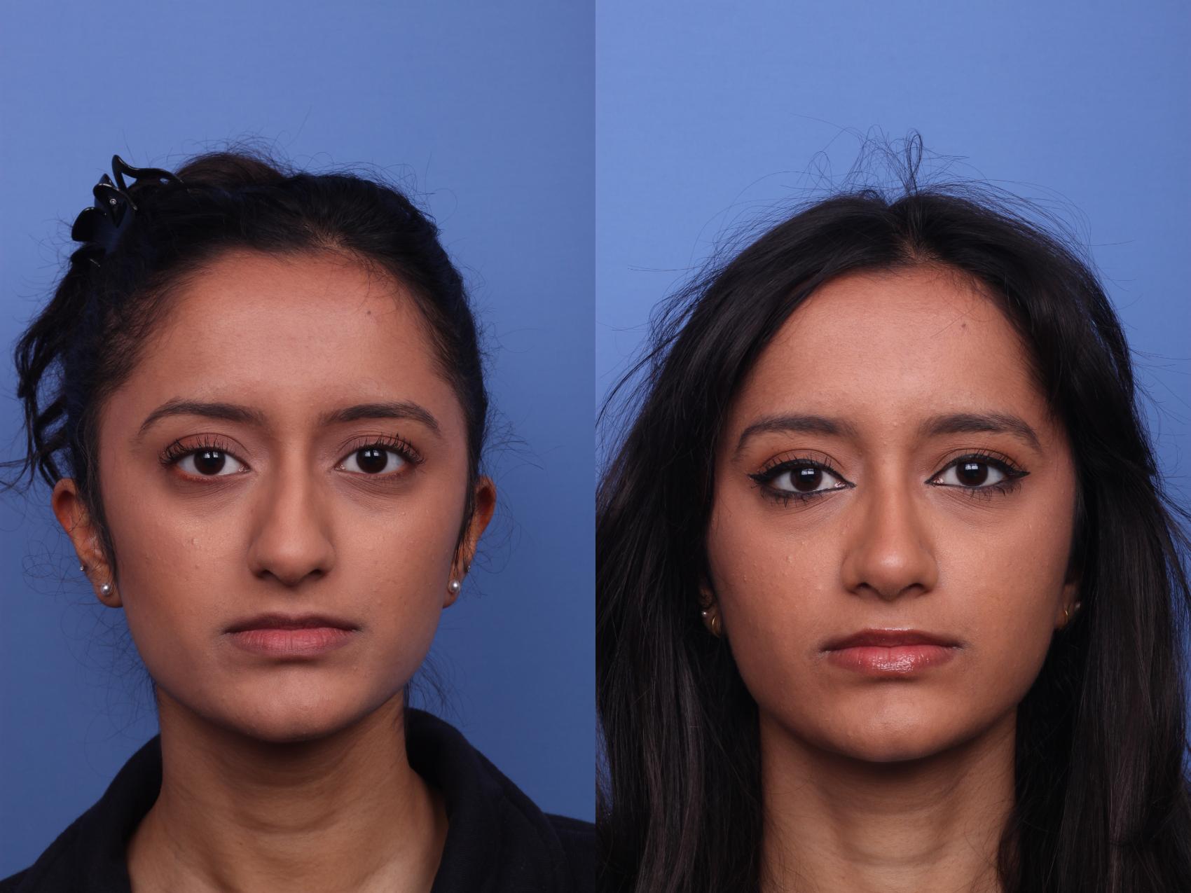 Rhinoplasty Before and After Pictures Case 411 | Scottsdale & Phoenix ...