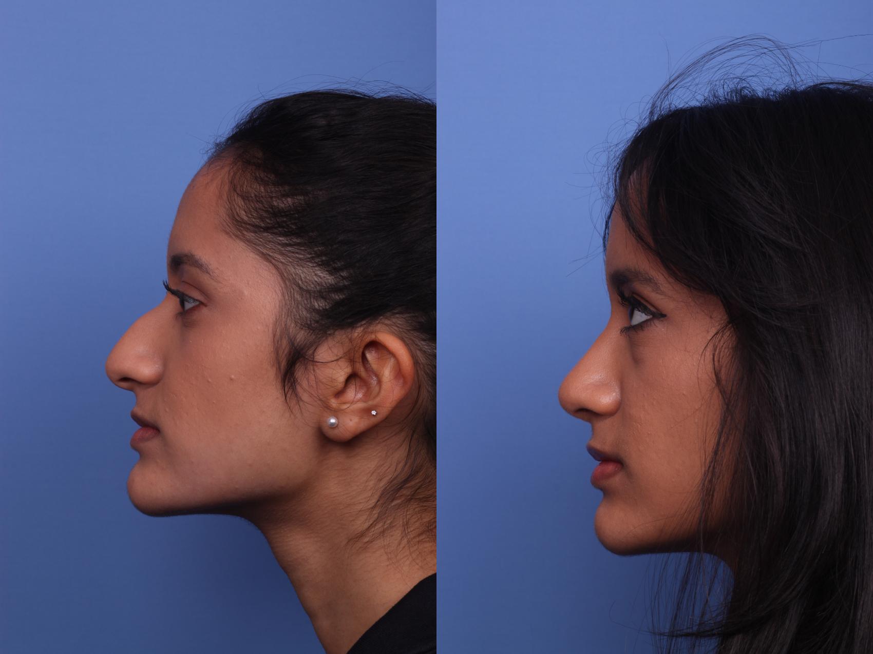 Rhinoplasty Before and After Pictures Case 411 | Scottsdale & Phoenix ...