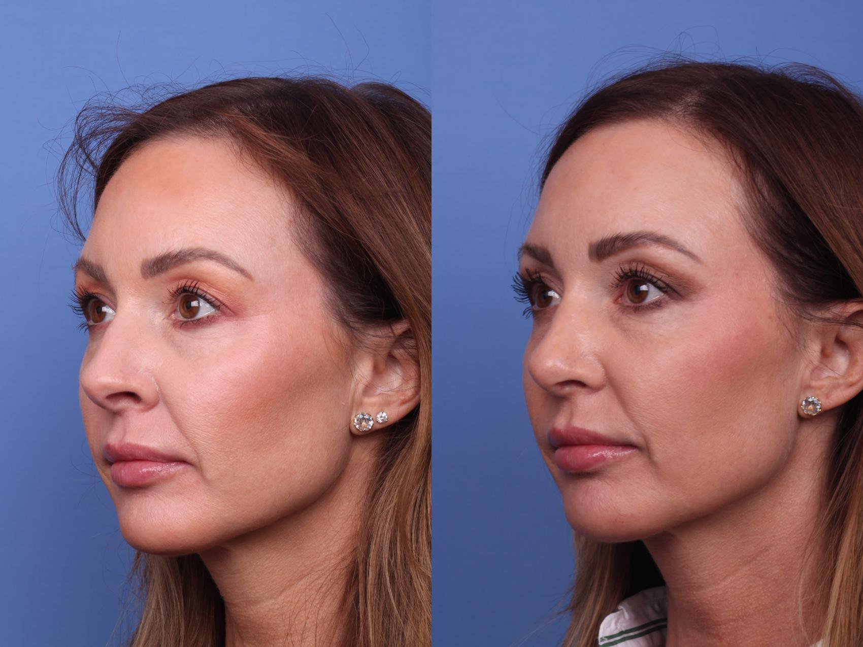 Rhinoplasty Before and After Pictures Case 417 | Scottsdale & Phoenix ...
