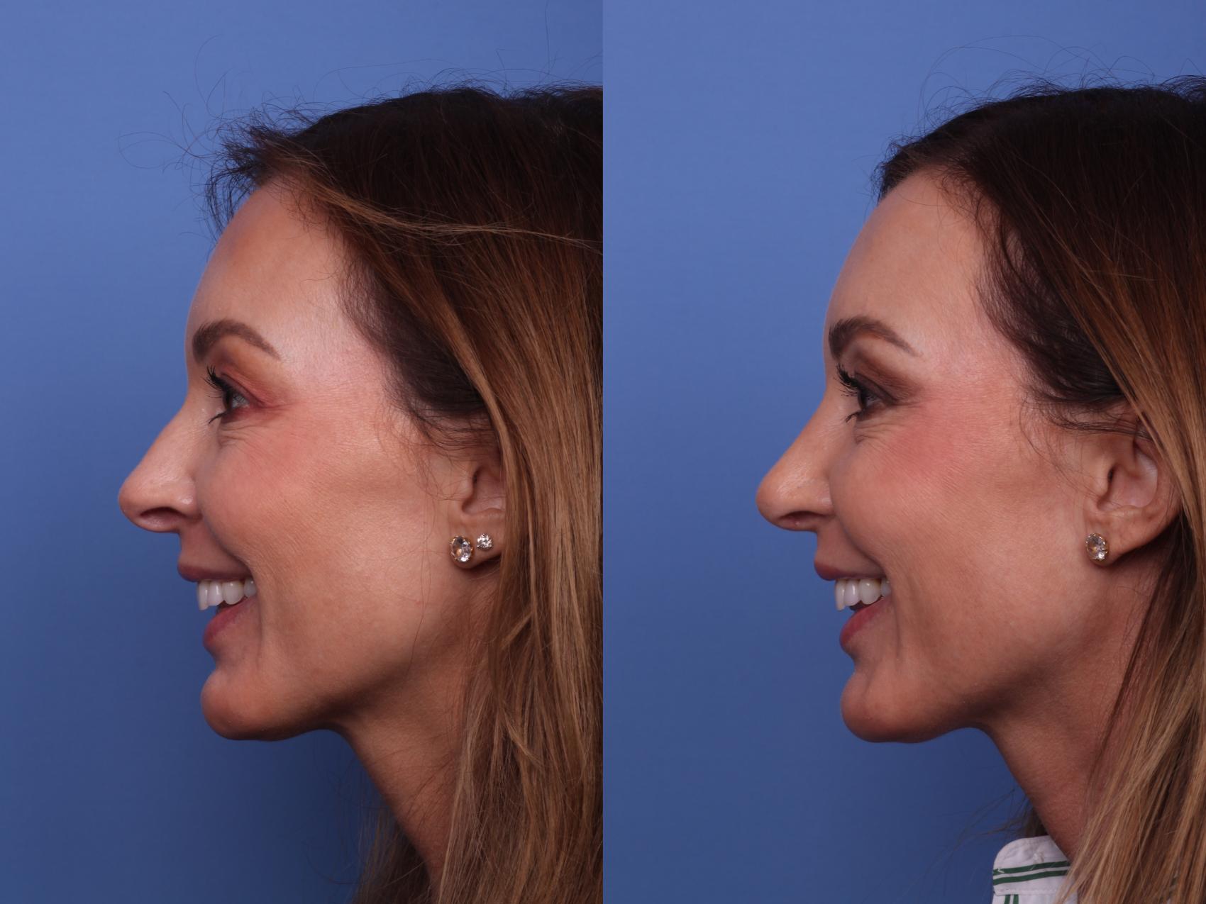 Rhinoplasty Before and After Pictures Case 417 | Scottsdale & Phoenix ...