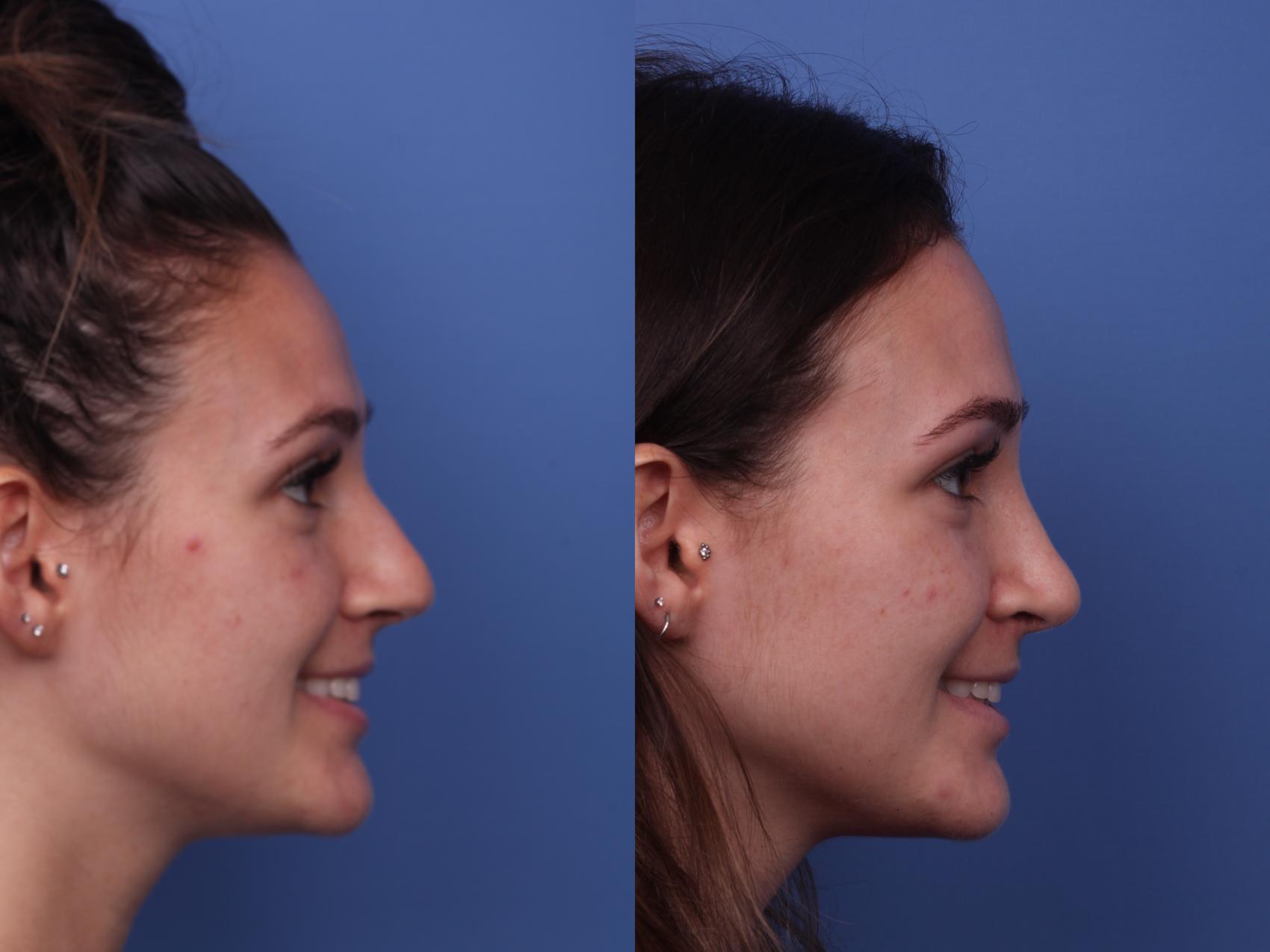 Rhinoplasty Before and After Pictures Case 425 | Scottsdale & Phoenix ...