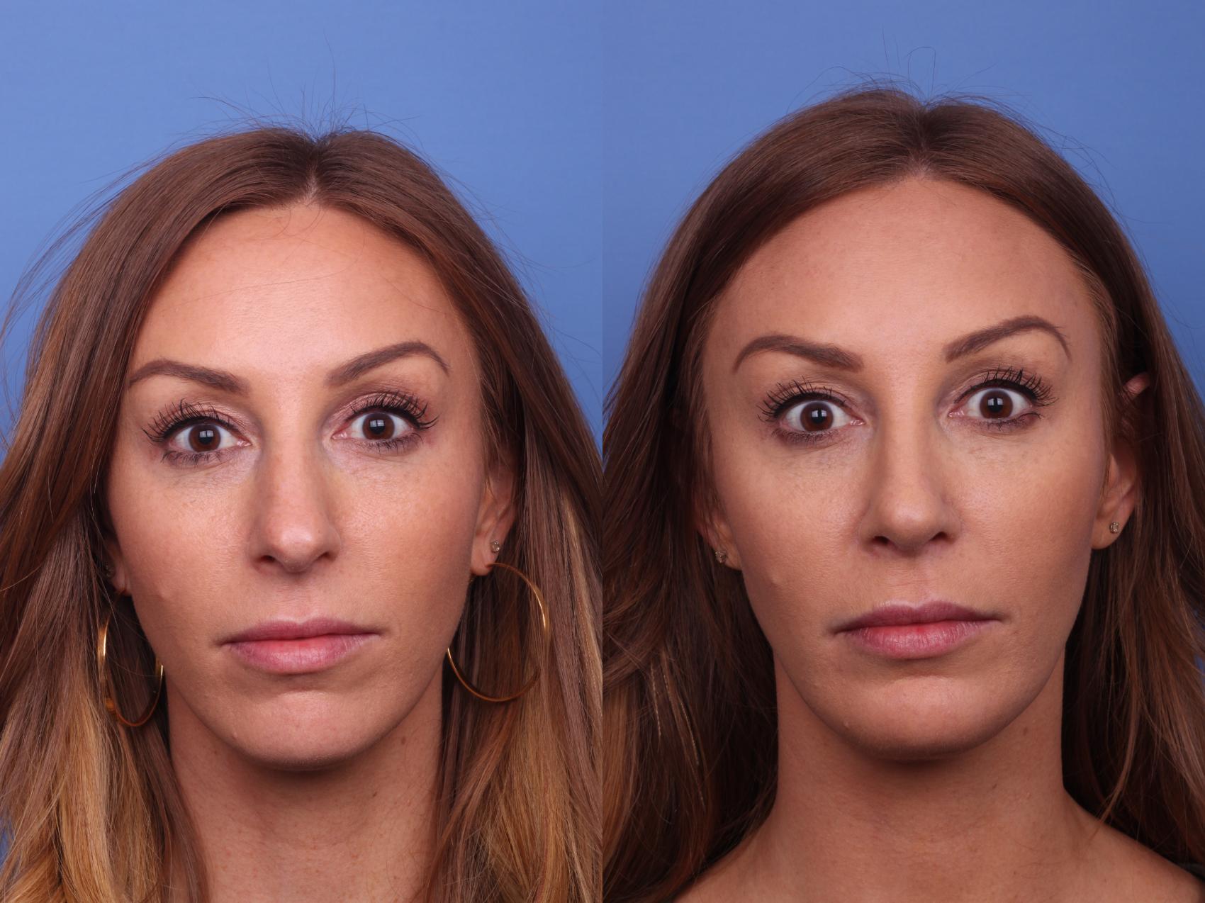 Rhinoplasty Before and After Pictures Case 432 | Scottsdale & Phoenix ...