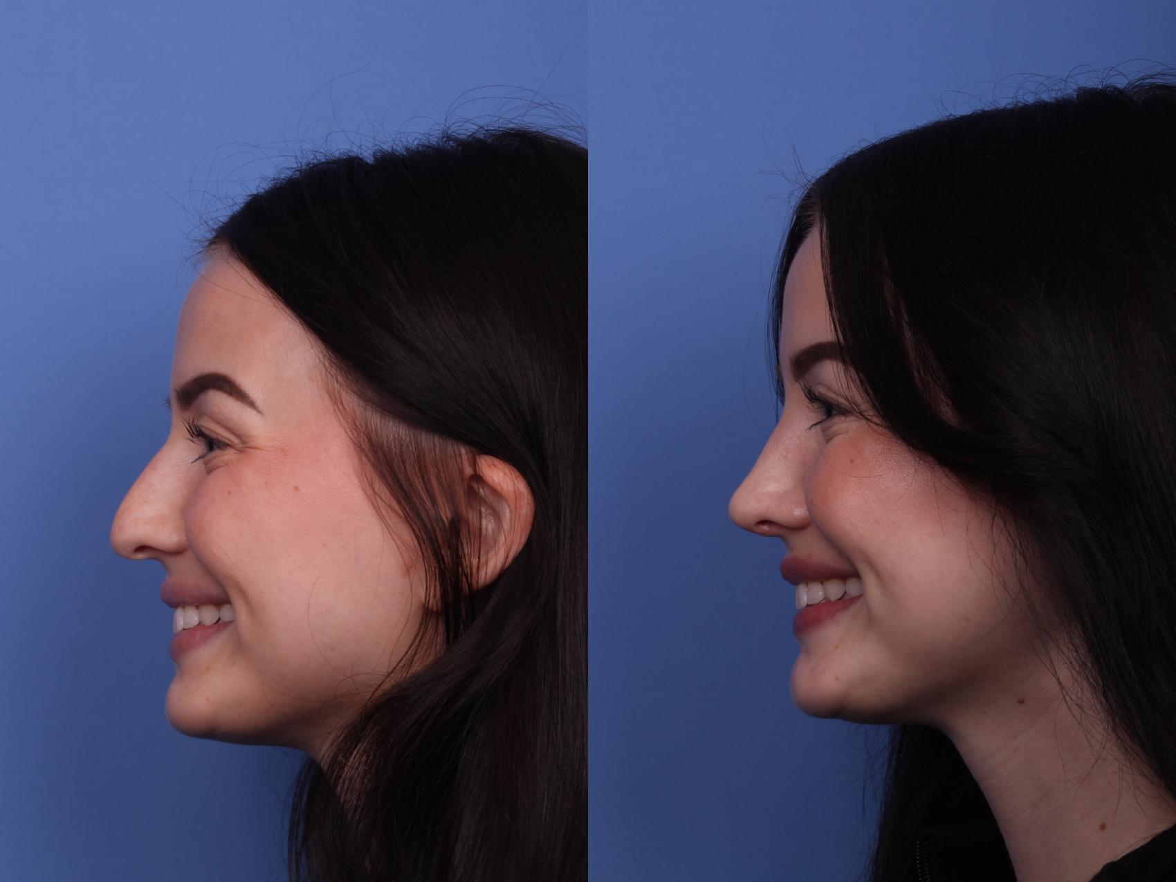 Rhinoplasty Before and After Pictures Case 438 | Scottsdale & Phoenix ...