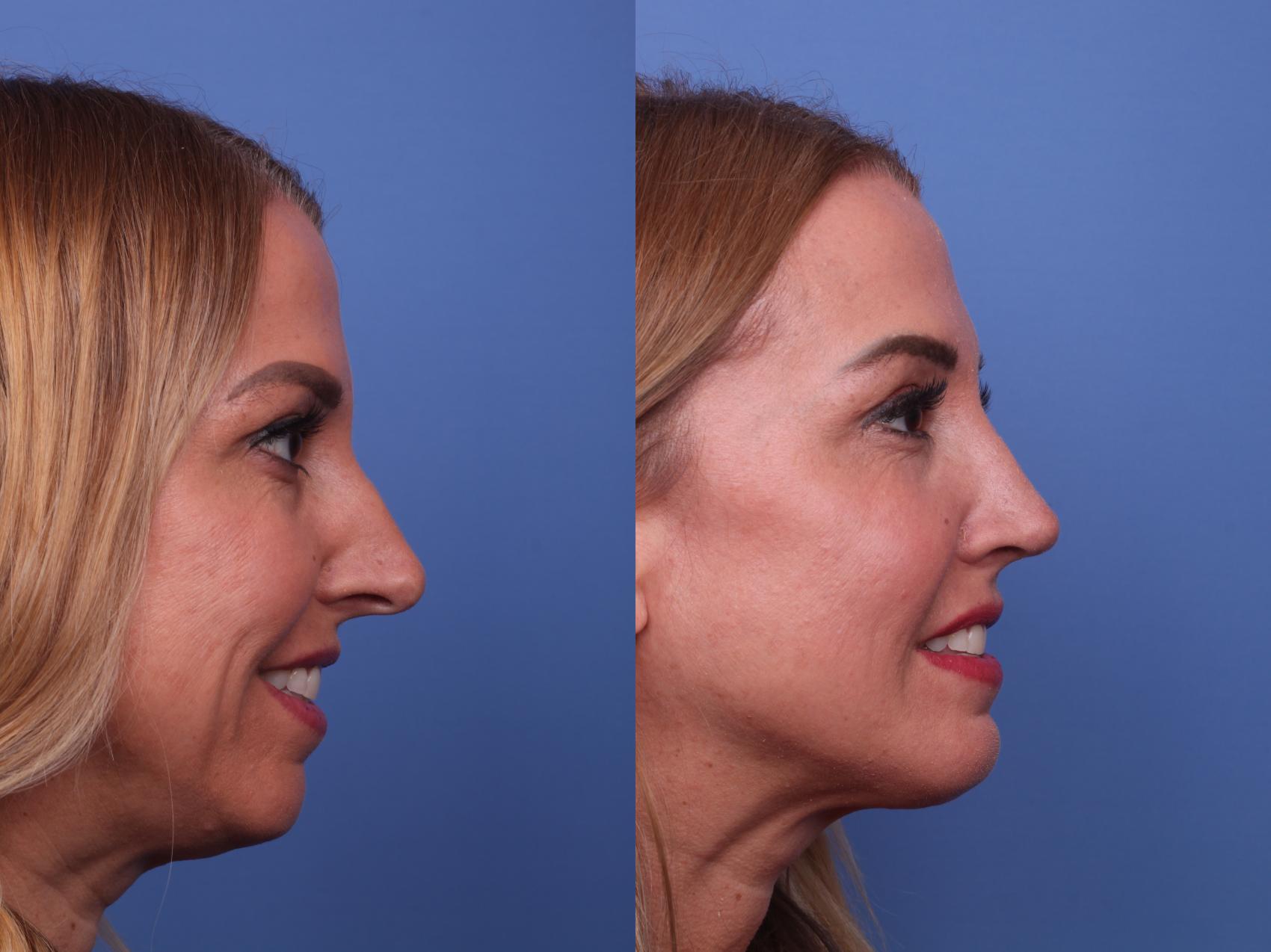 Rhinoplasty Before and After Pictures Case 439 | Scottsdale & Phoenix ...