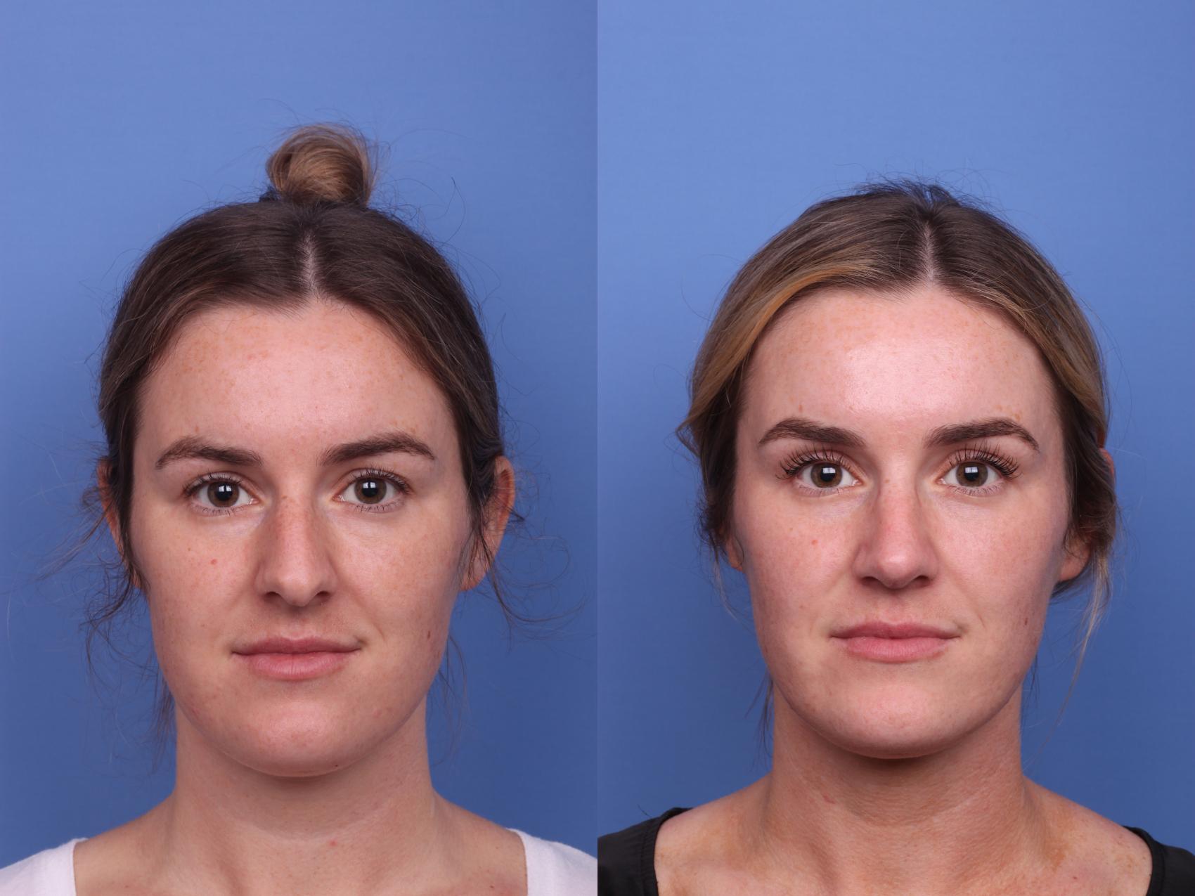Rhinoplasty Before and After Pictures Case 458 | Scottsdale & Phoenix ...