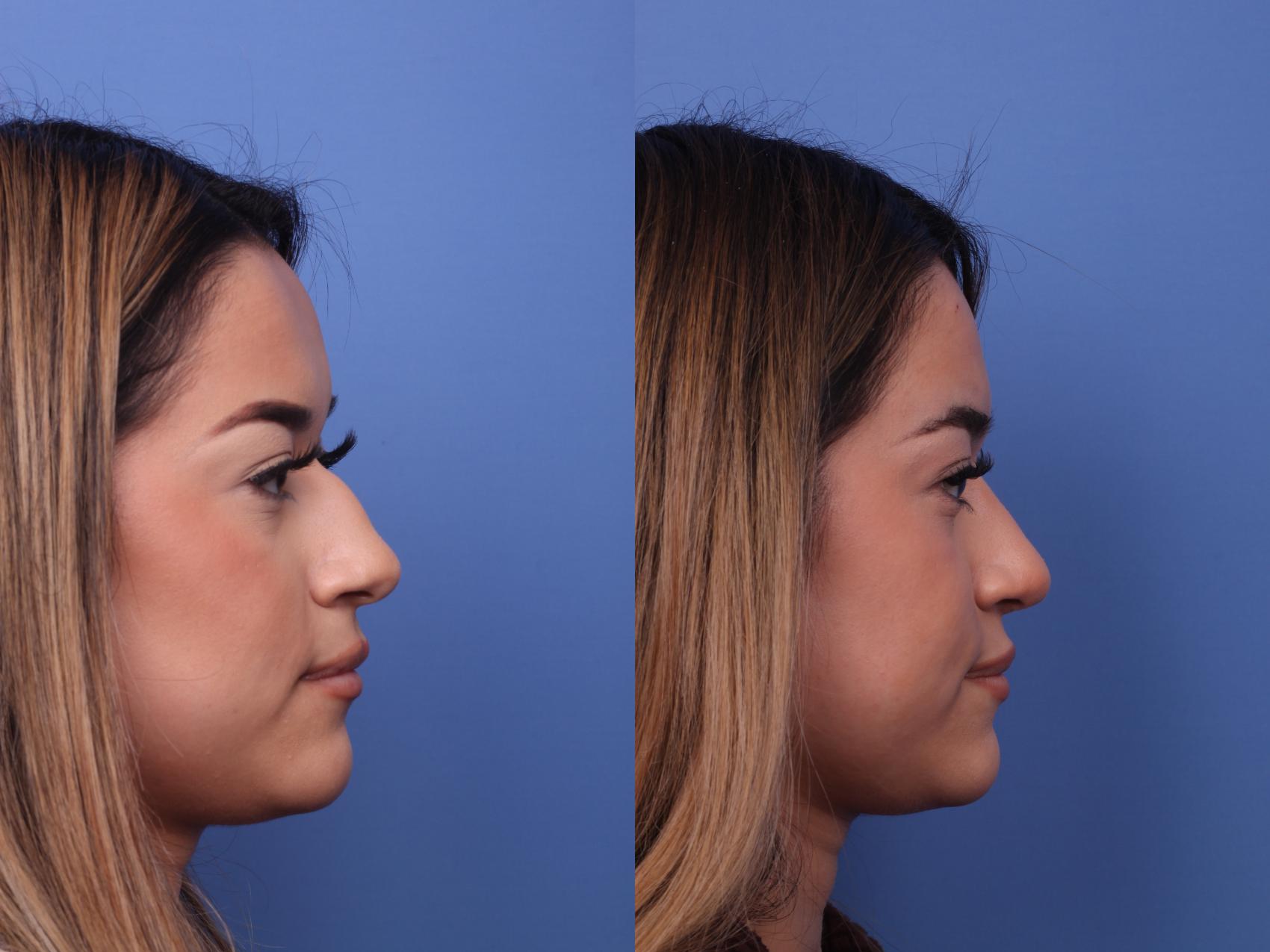 Rhinoplasty Before and After Pictures Case 463 | Scottsdale & Phoenix ...