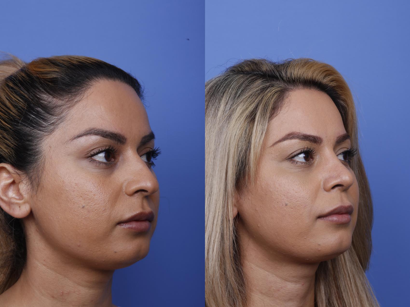 Rhinoplasty Before and After Pictures Case 481 | Scottsdale & Phoenix ...