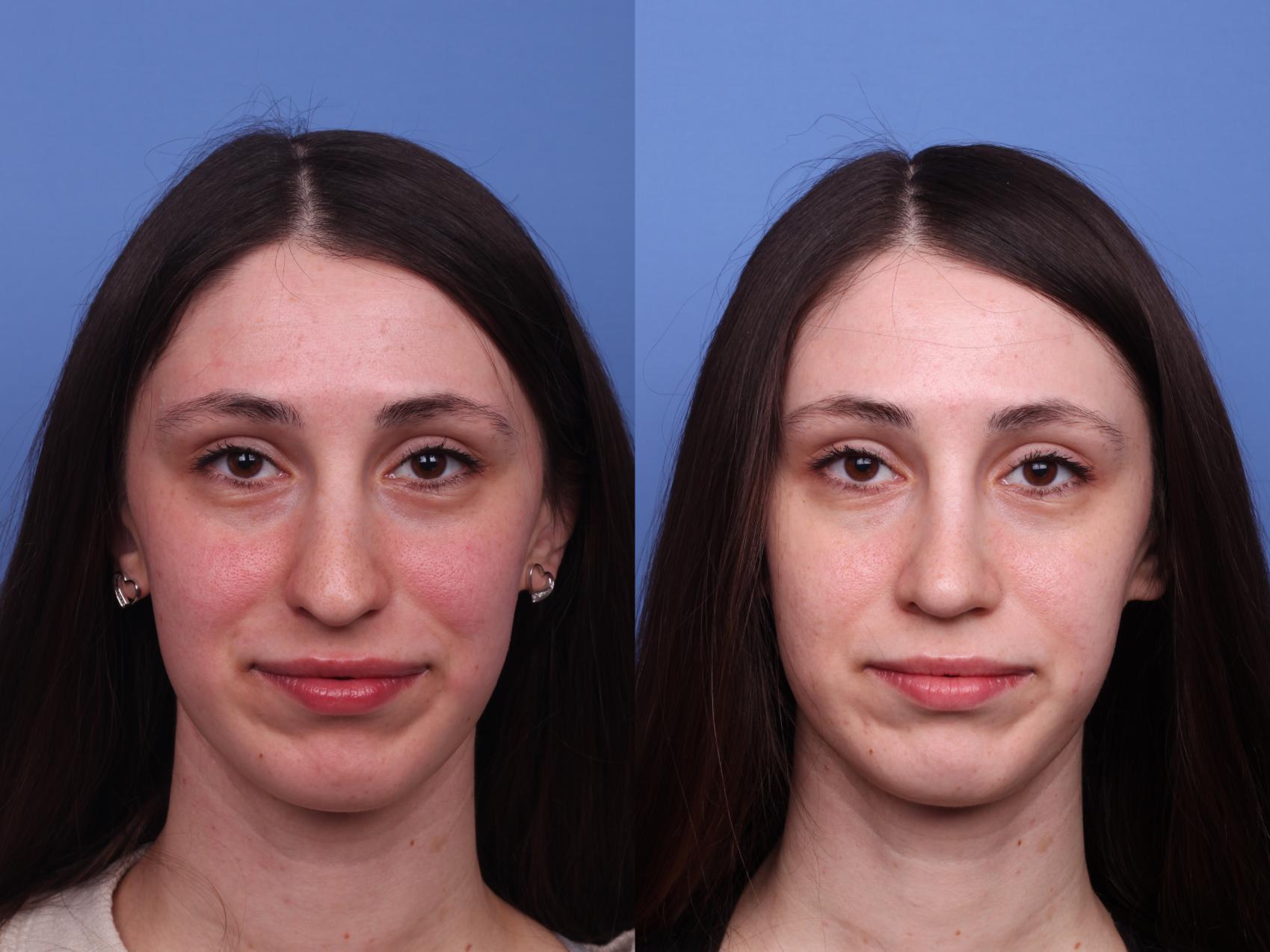 Rhinoplasty Before and After Pictures Case 483 | Scottsdale & Phoenix ...