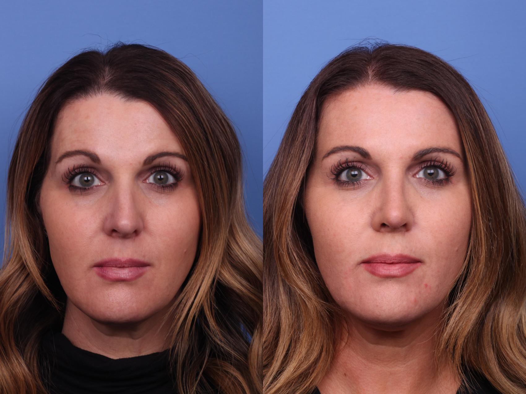 Rhinoplasty Before and After Pictures Case 494 | Scottsdale & Phoenix ...