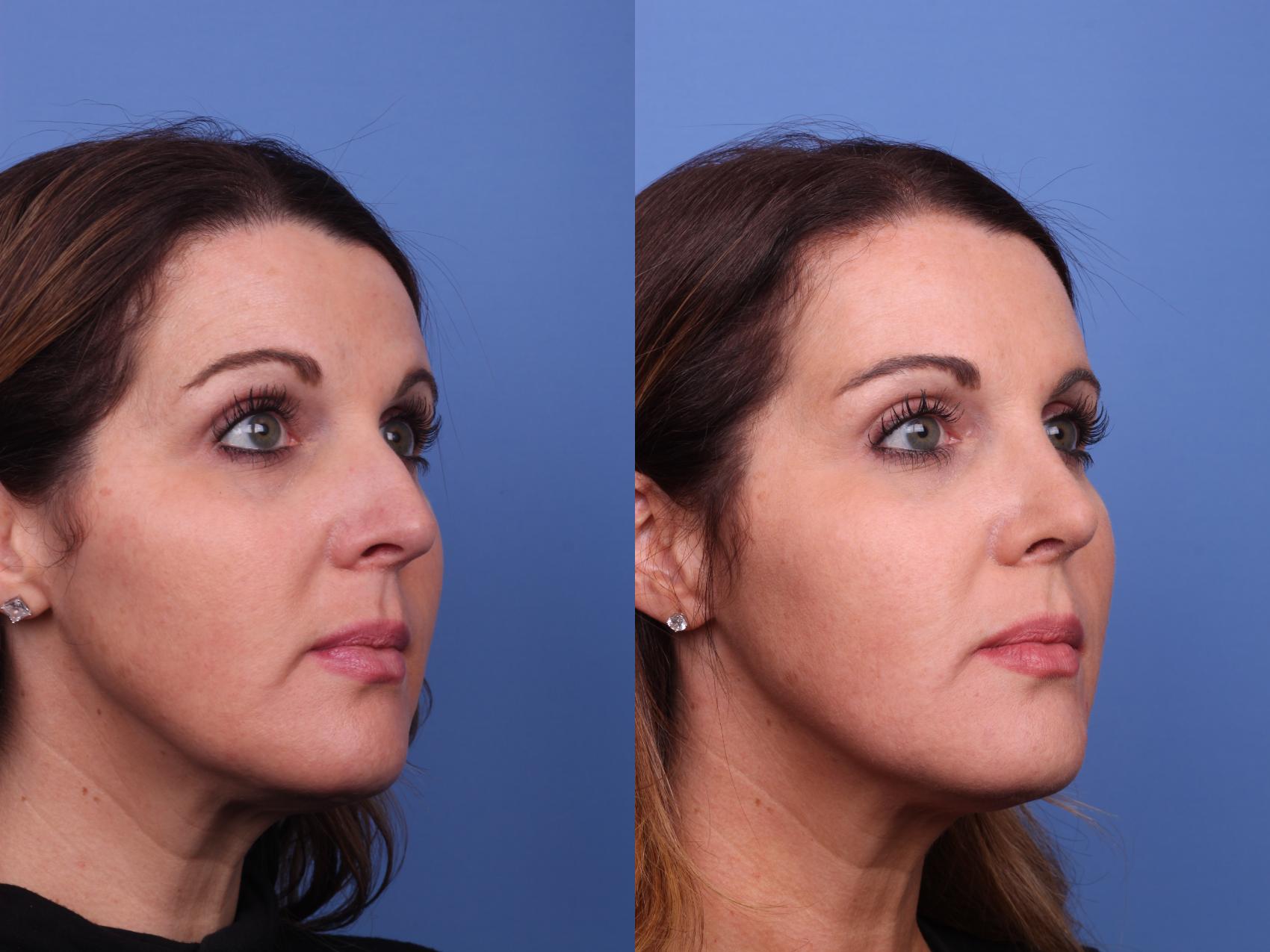 Rhinoplasty Before and After Pictures Case 494 | Scottsdale & Phoenix ...