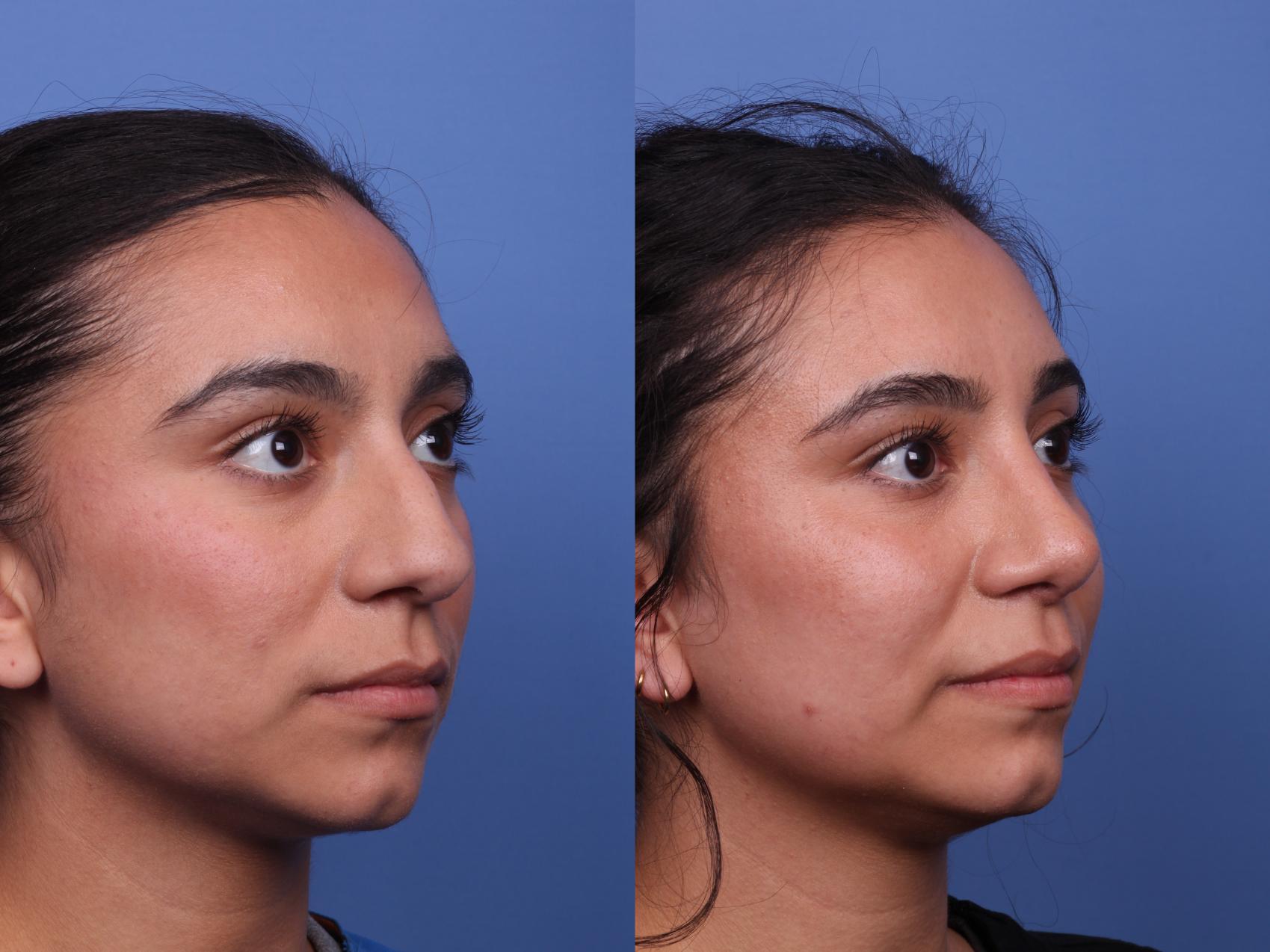 Rhinoplasty Before and After Pictures Case 504 | Scottsdale & Phoenix ...