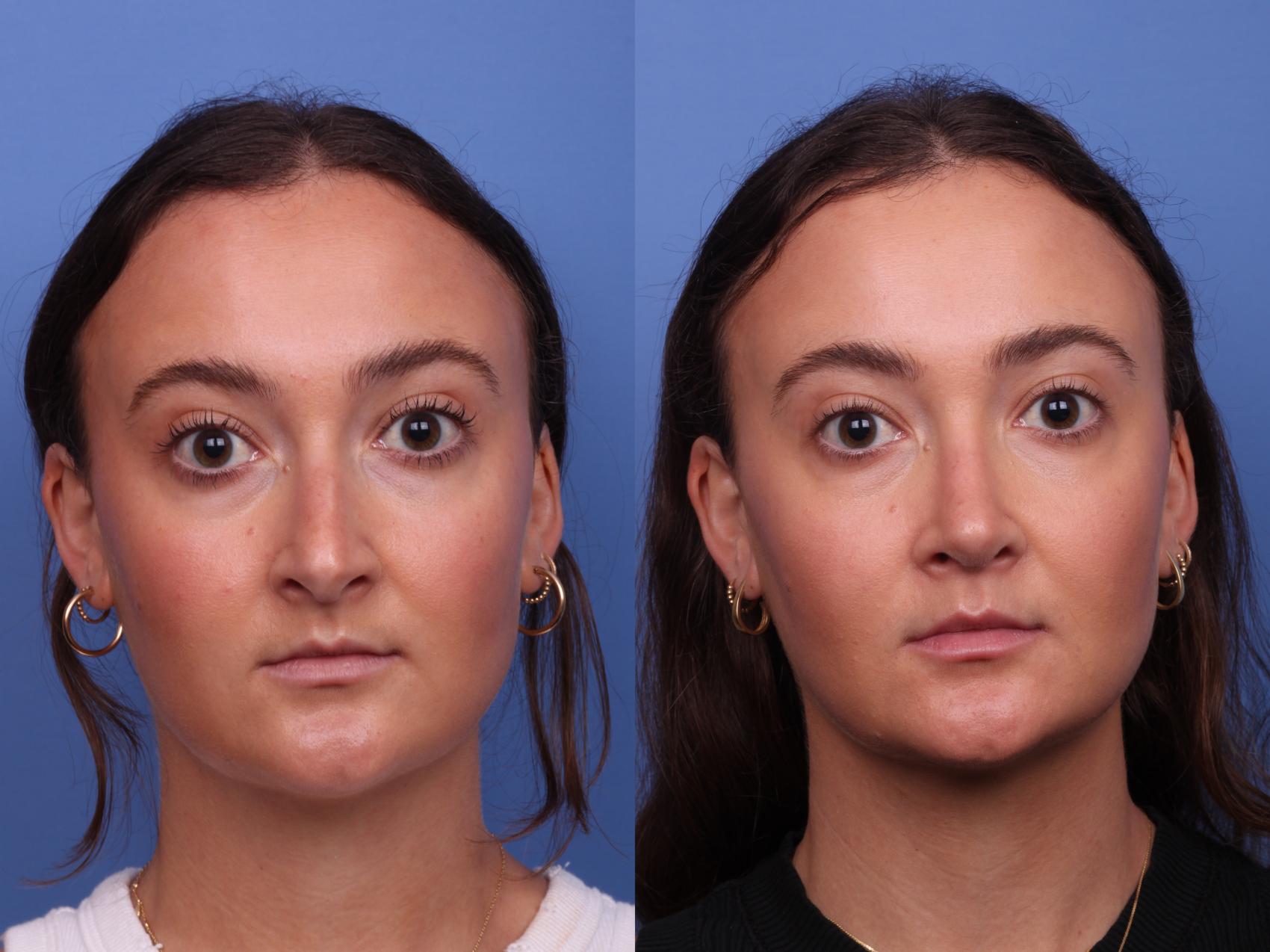 Rhinoplasty Before and After Pictures Case 510 | Scottsdale & Phoenix ...