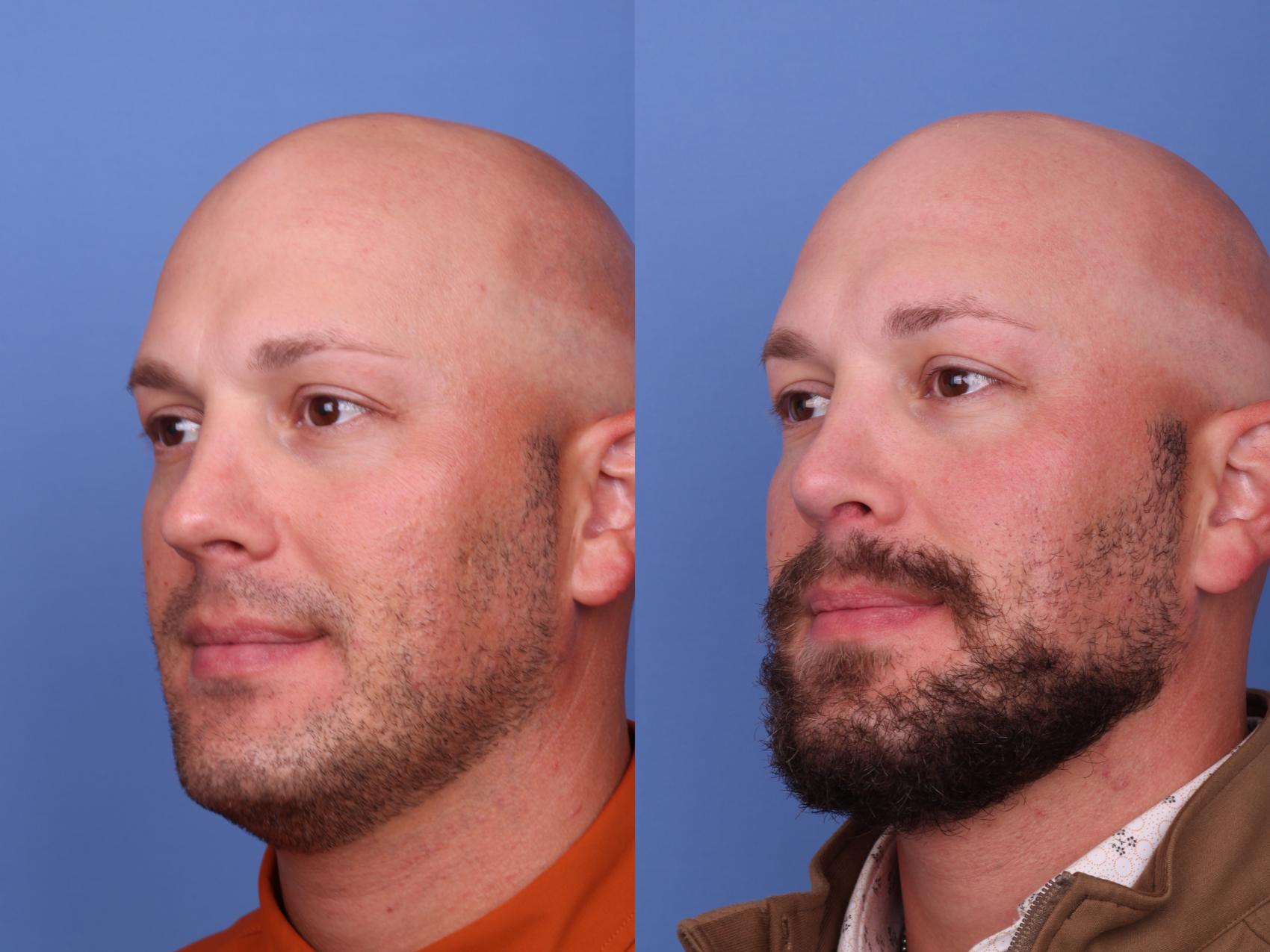 Rhinoplasty Before and After Pictures Case 555 | Scottsdale & Phoenix ...