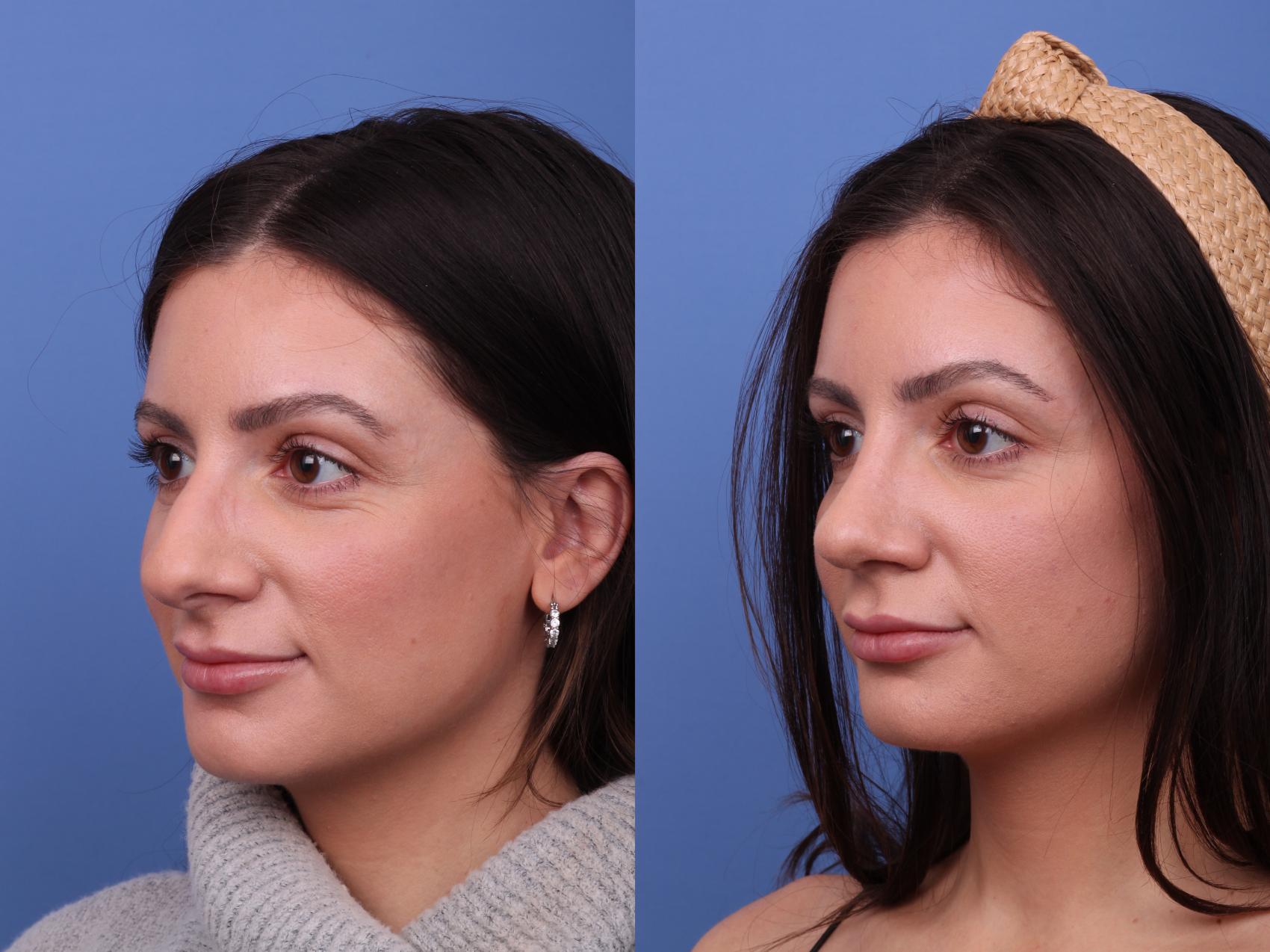 Rhinoplasty Before and After Pictures Case 583 | Scottsdale & Phoenix ...